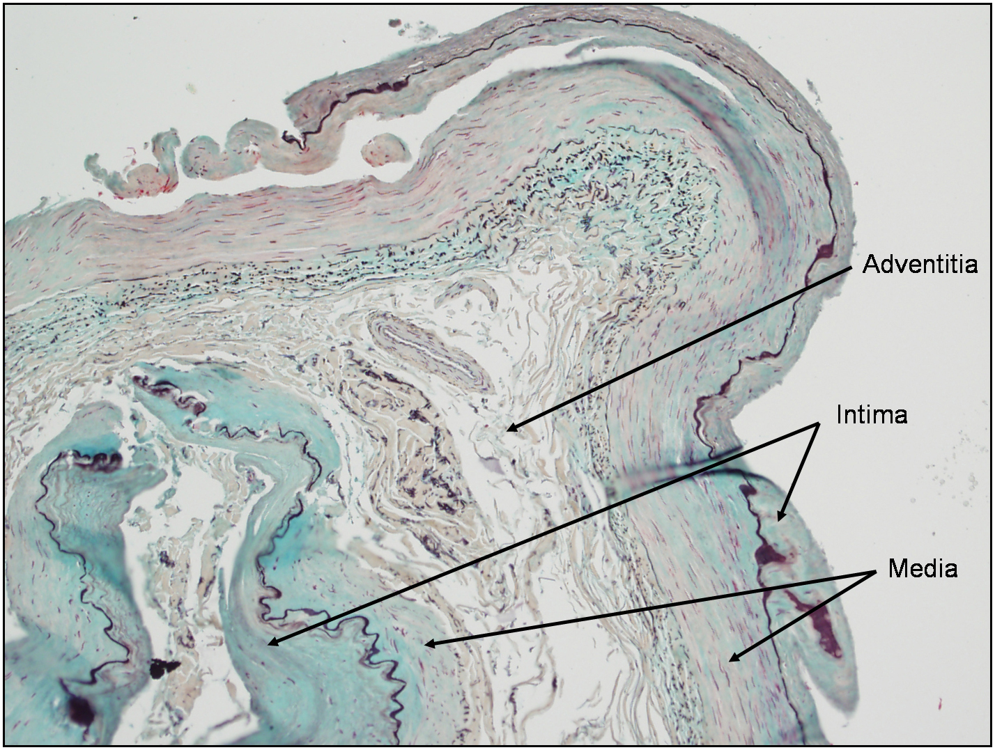 Radial Artery Avulsion: A Rare Complication of Percutaneous Coronary ...