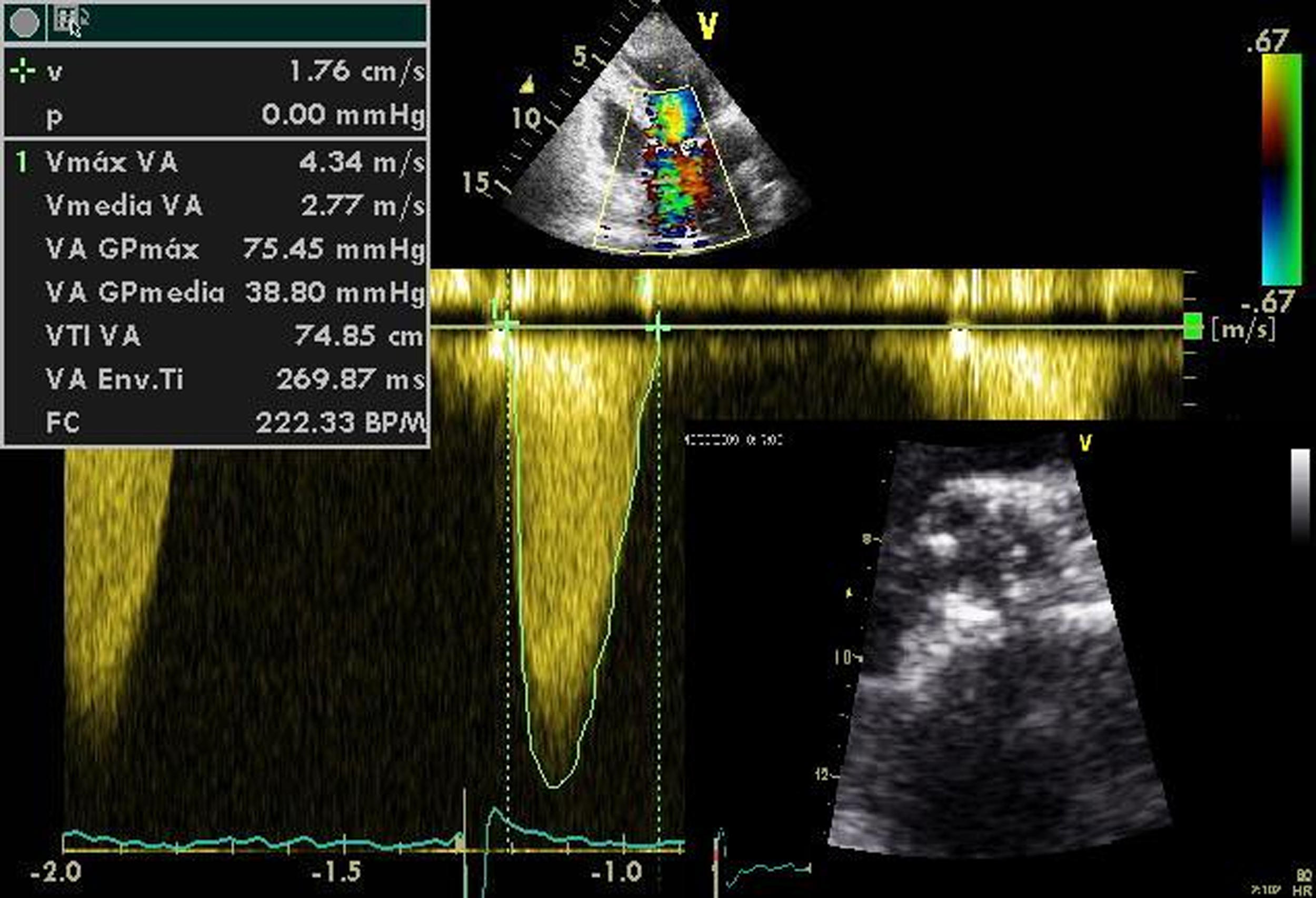 Heyde's Syndrome | Revista Española de Cardiología