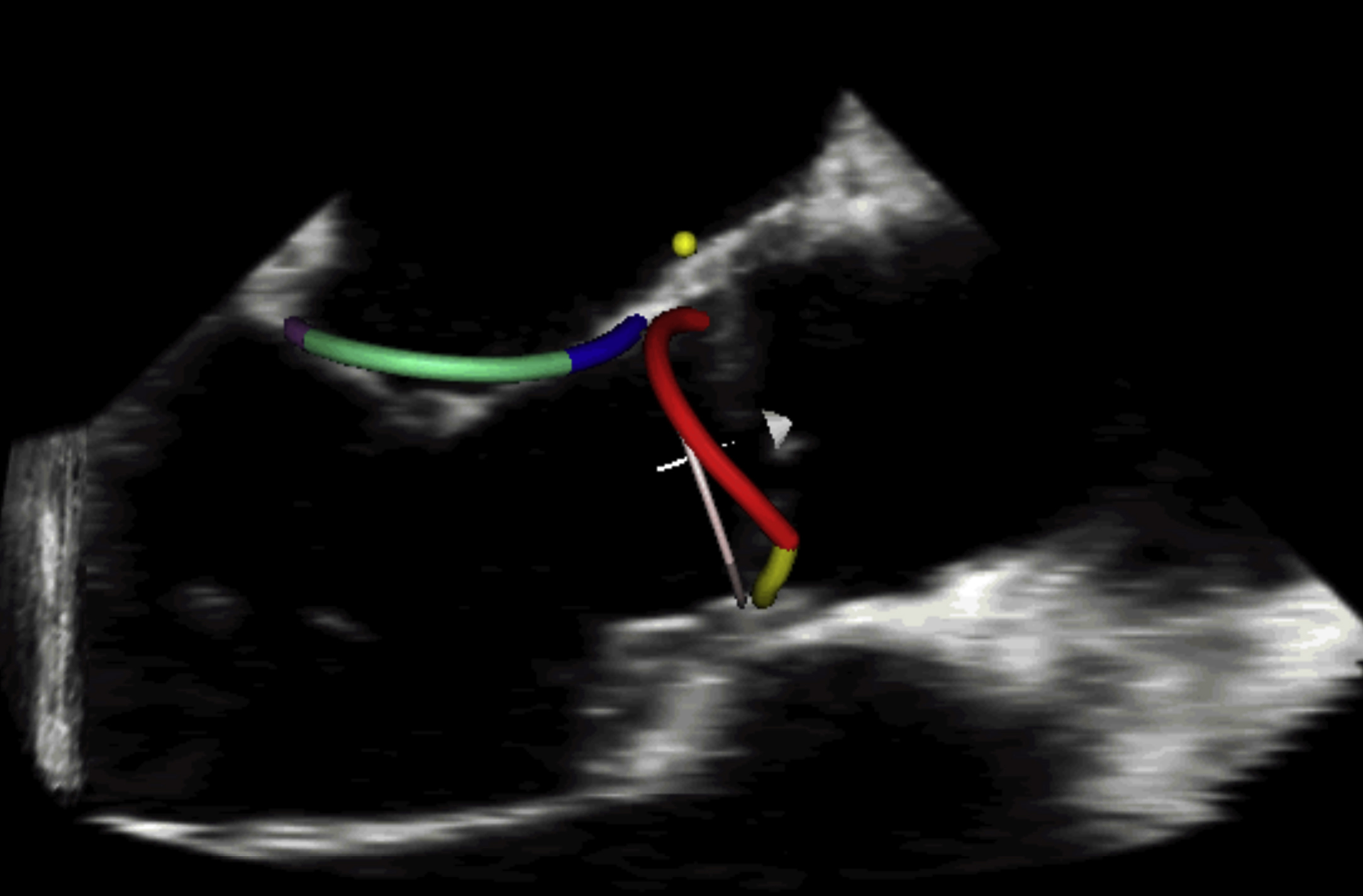 Three-dimensional Echocardiography in the Assessment of Prosthetic ...