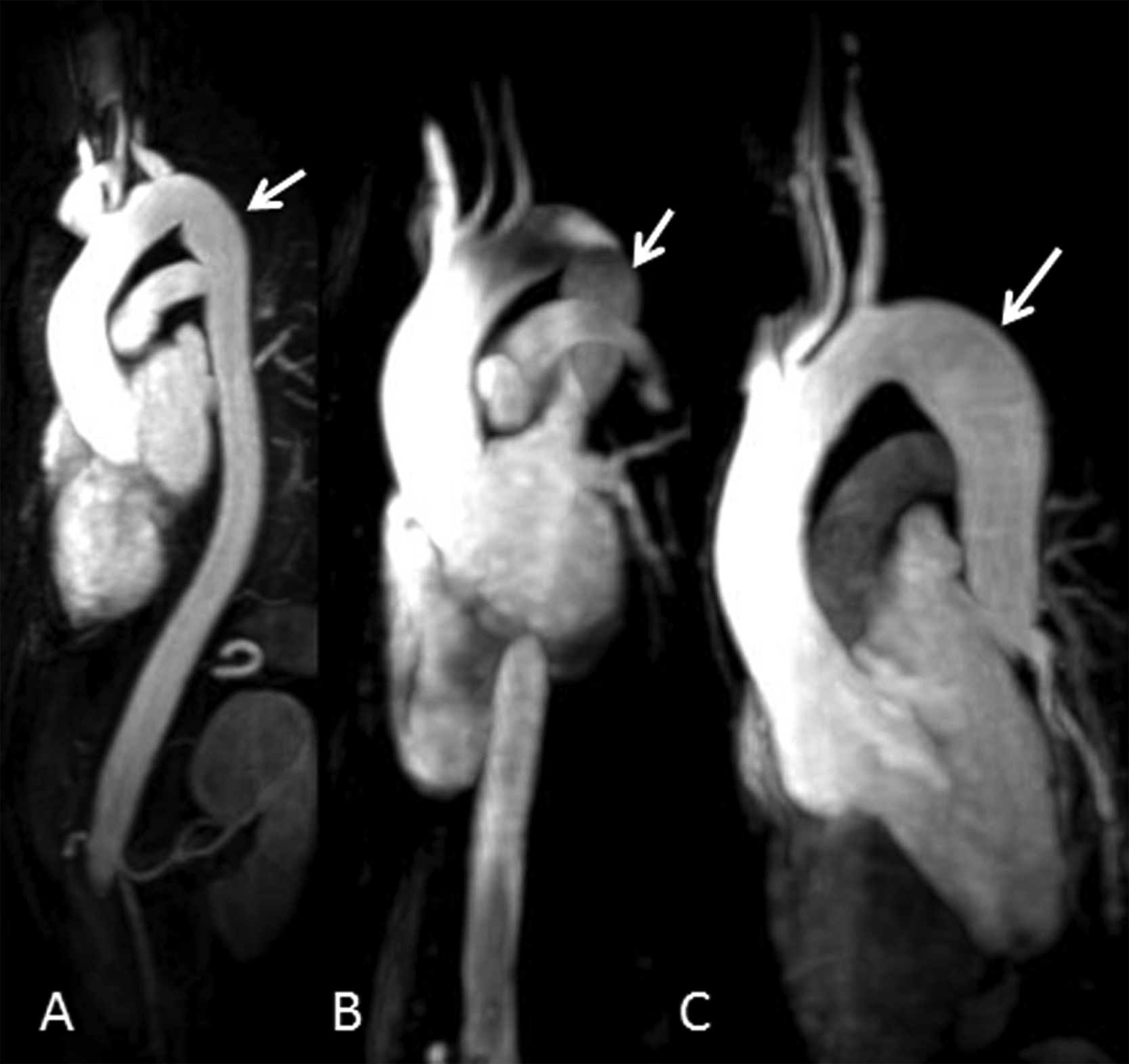 Value of Molecular Diagnosis in a Family With Marfan Syndrome and an ...