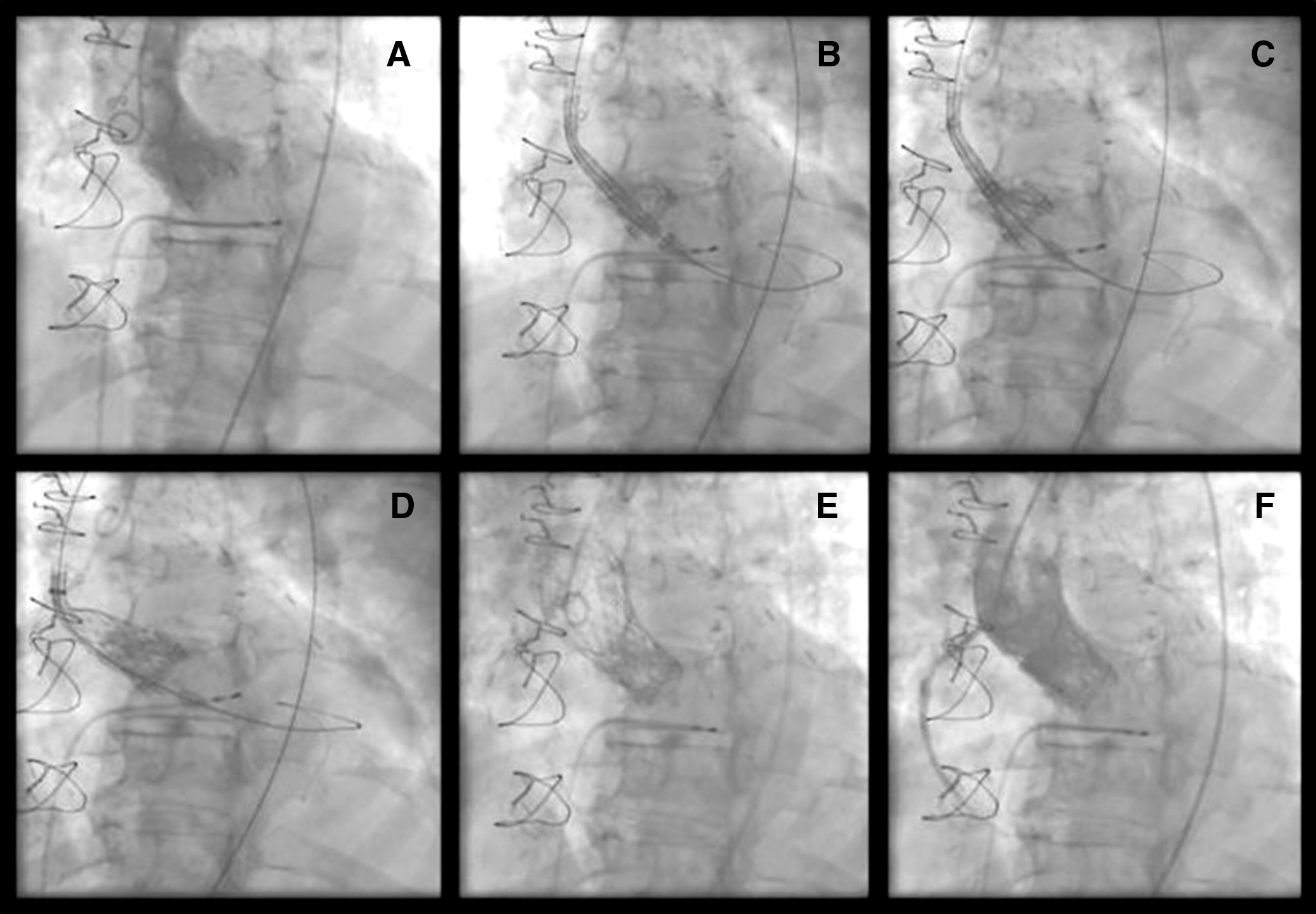 Percutaneous Treatment of a Dysfunctional Aortic Bioprosthesis With the ...