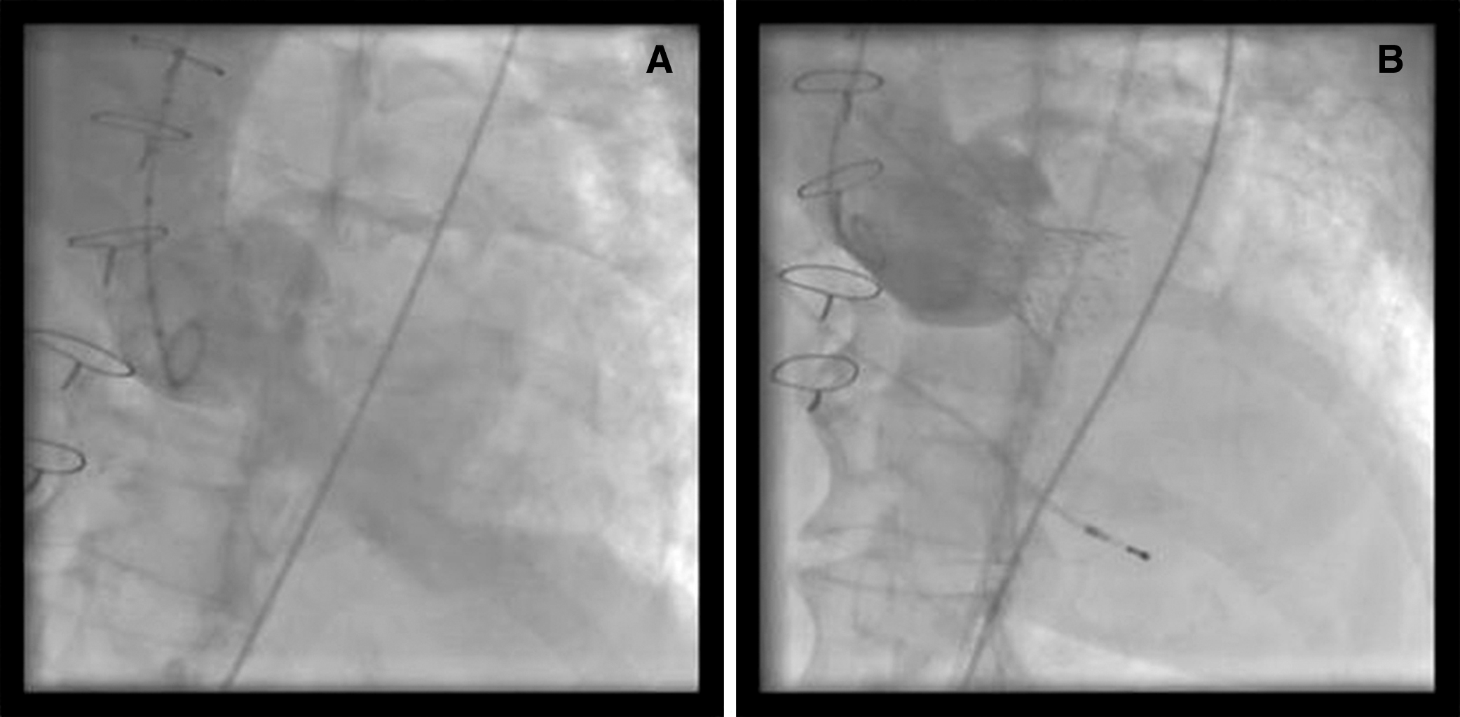 Percutaneous Treatment of a Dysfunctional Aortic Bioprosthesis With the ...