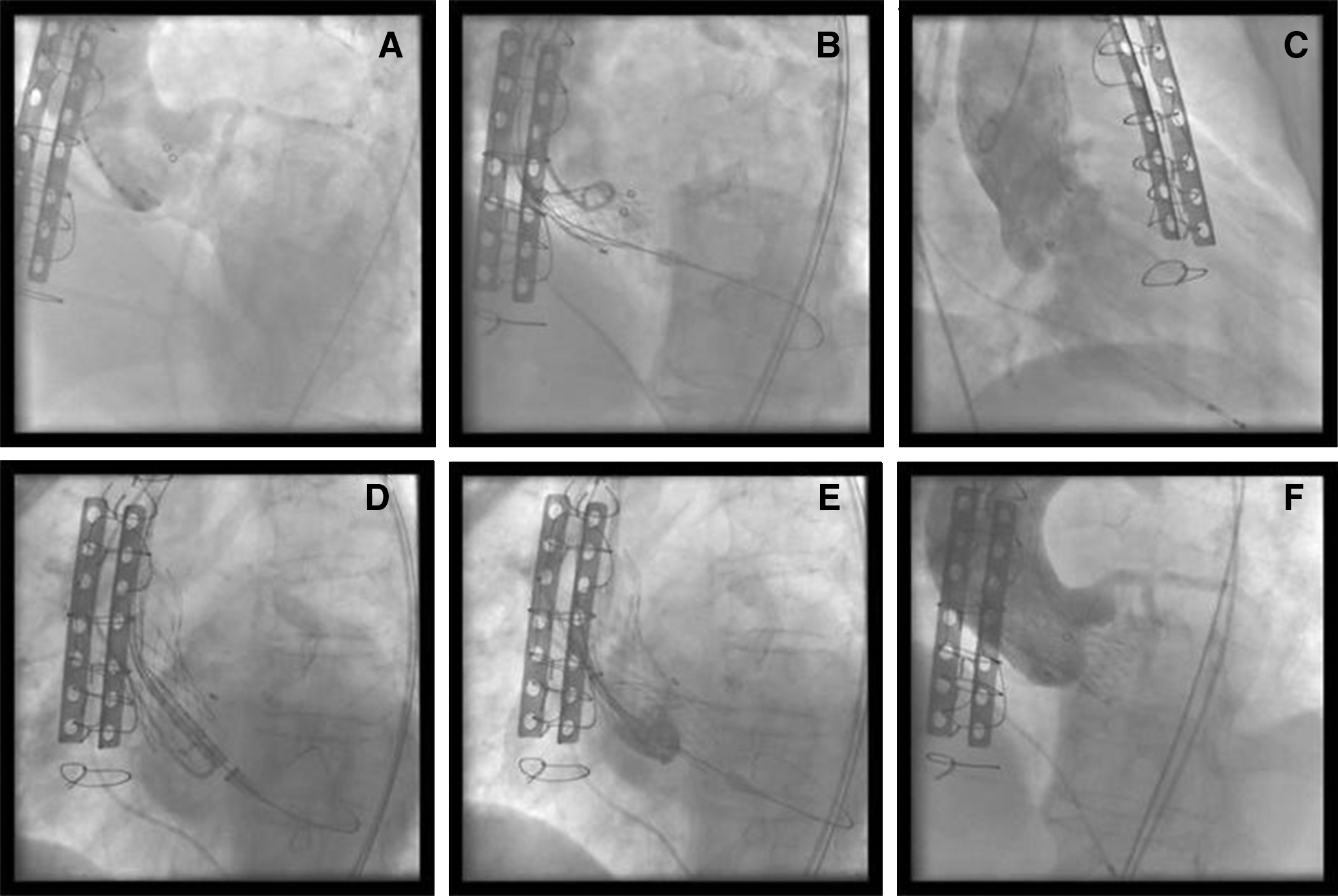 Percutaneous Treatment of a Dysfunctional Aortic Bioprosthesis With the ...