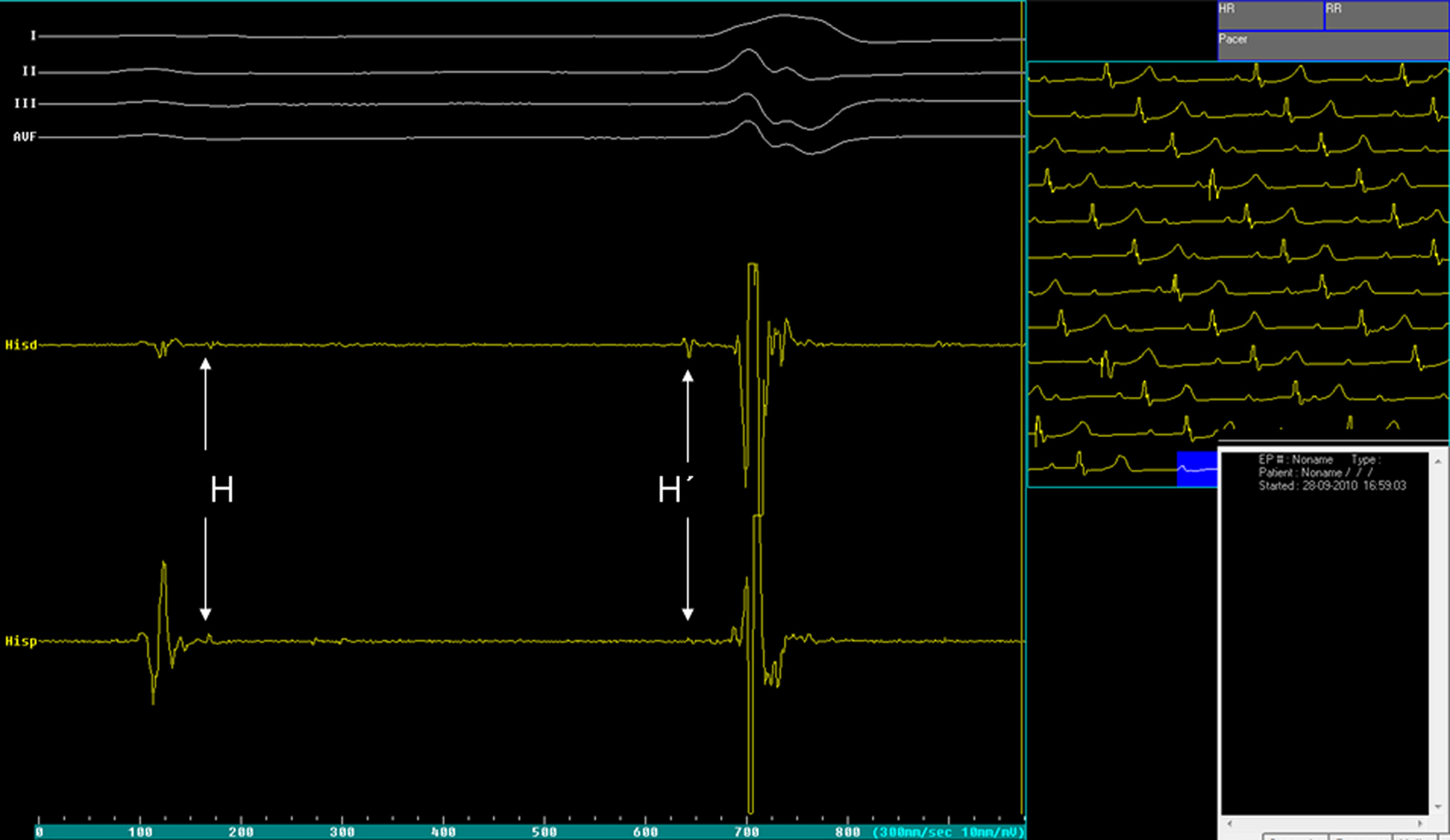 Intra-Hisian Block During Transcatheter Aortic Valve Implantation With ...