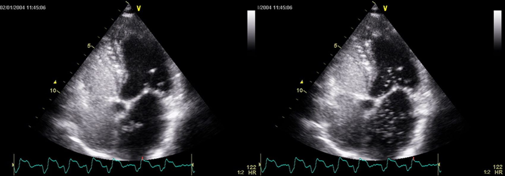 Diagnosis and Quantification of Patent Foramen Ovale. Which Is the ...