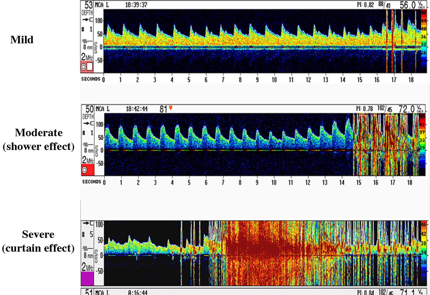 Diagnosis and Quantification of Patent Foramen Ovale. Which Is the ...