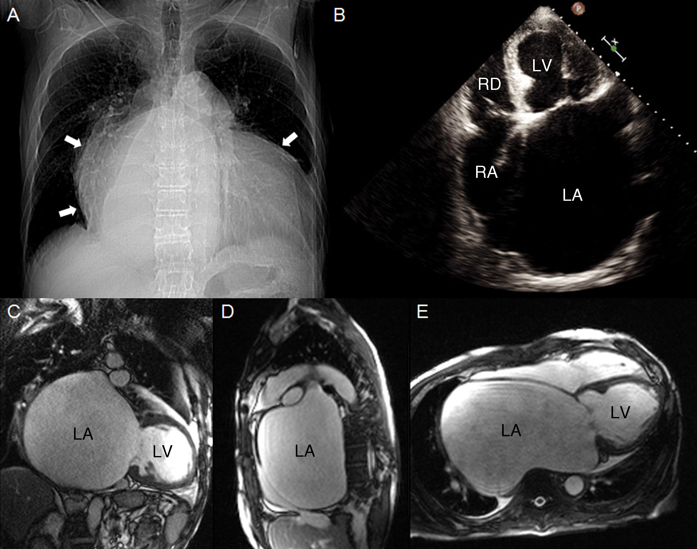 Giant Left Atrium Investigated by Magnetic Resonance Imaging