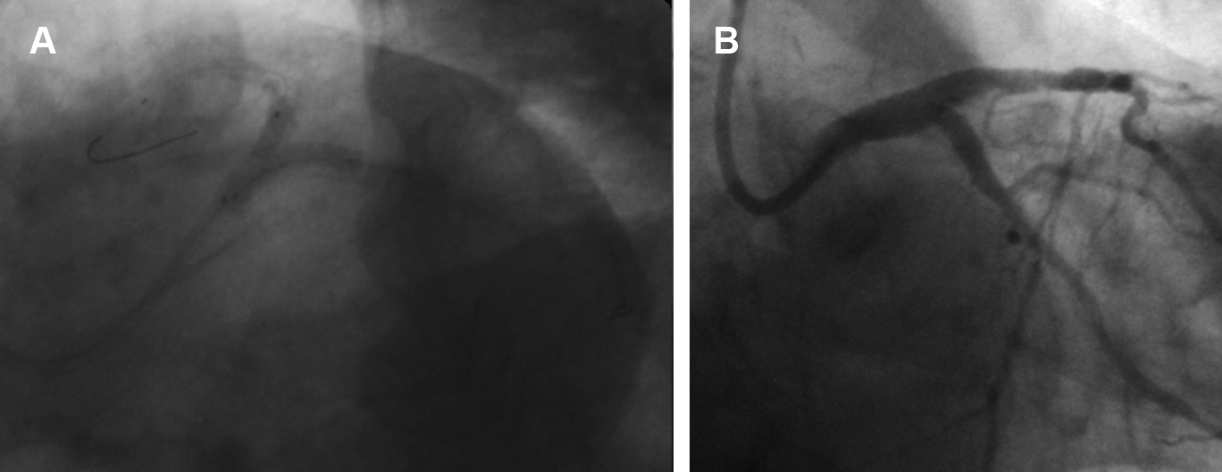 Rotational Atherectomy Through Radial Access With a 7.5 Fr Sheathless ...