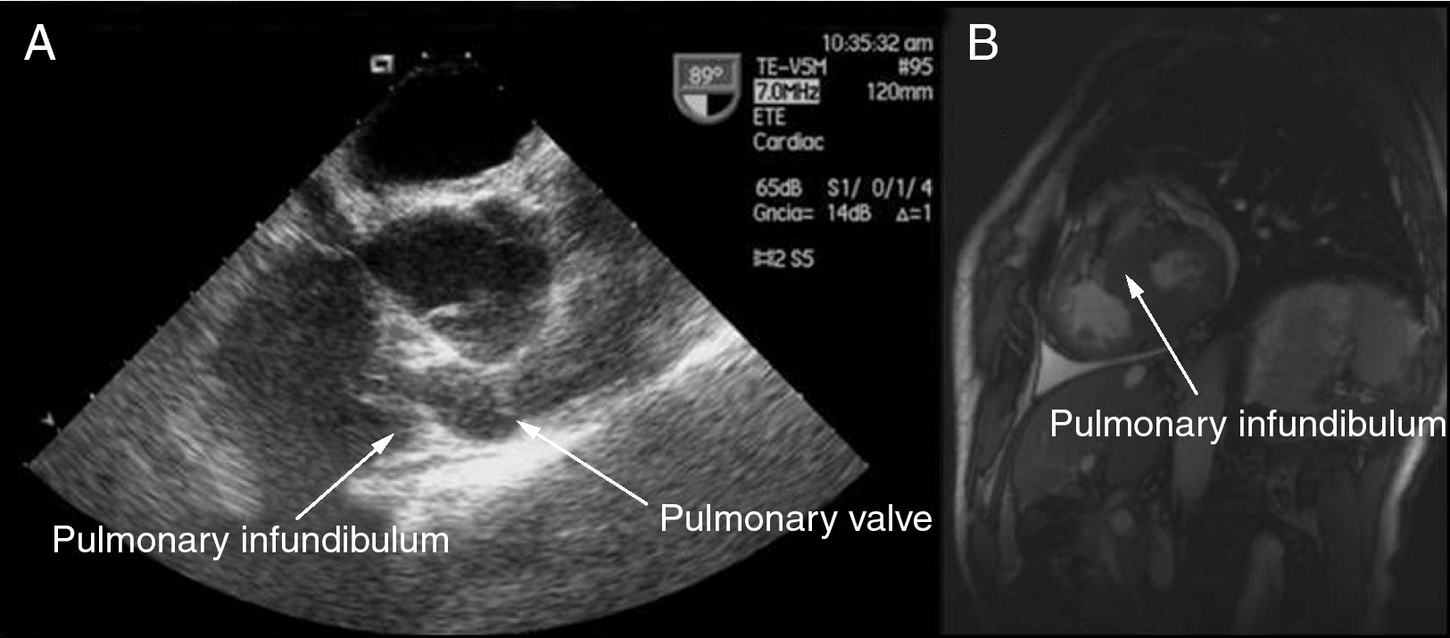 Cardiac Abnormalities in LEOPARD Syndrome | Revista Española de Cardiología