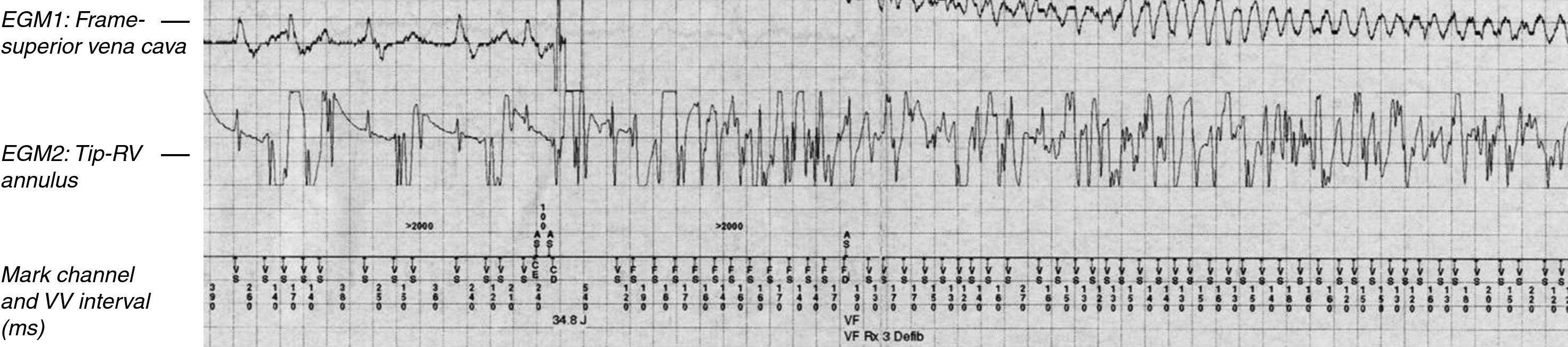 Sprint Fidelis Defibrillation Lead: a Nine-Center Experience in Spain ...