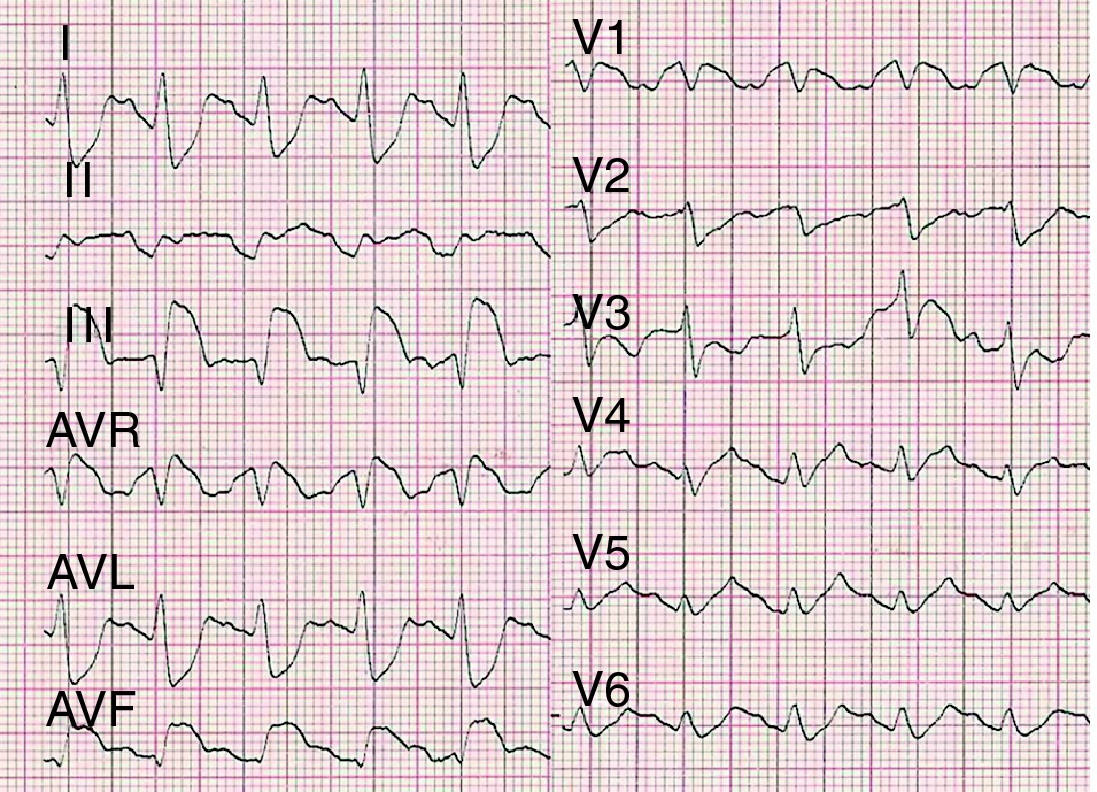 Pseudo Inferior Myocardial Infarction Pattern Caused by Hyperkalemia ...