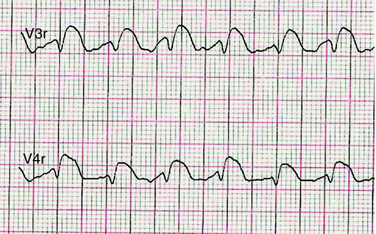 Pseudo Inferior Myocardial Infarction Pattern Caused by Hyperkalemia ...