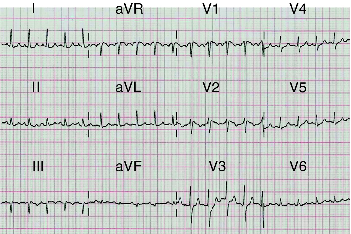 Pseudo Inferior Myocardial Infarction Pattern Caused by Hyperkalemia ...