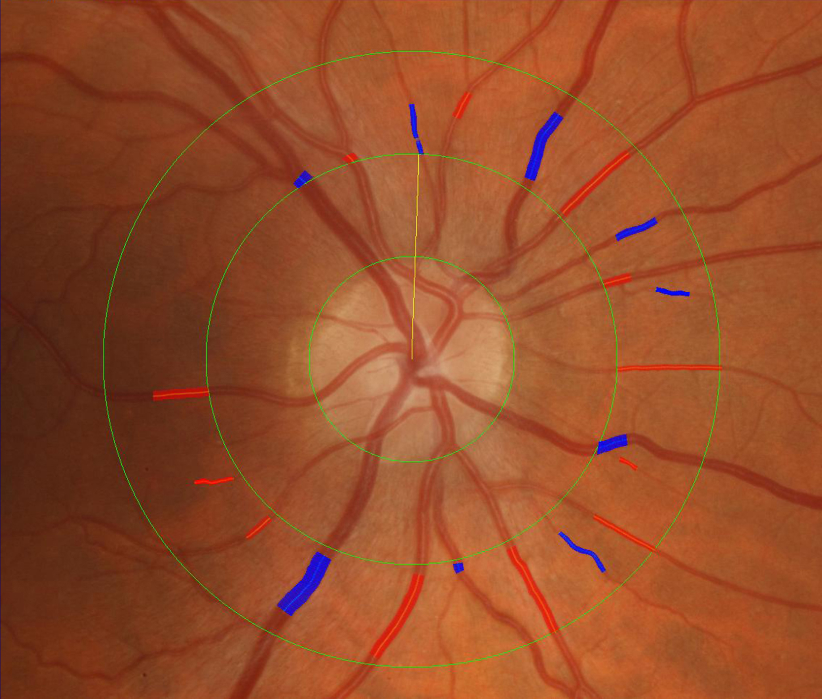 Retinal Vascular Signs: A Window to the Heart? | Revista Española de ...