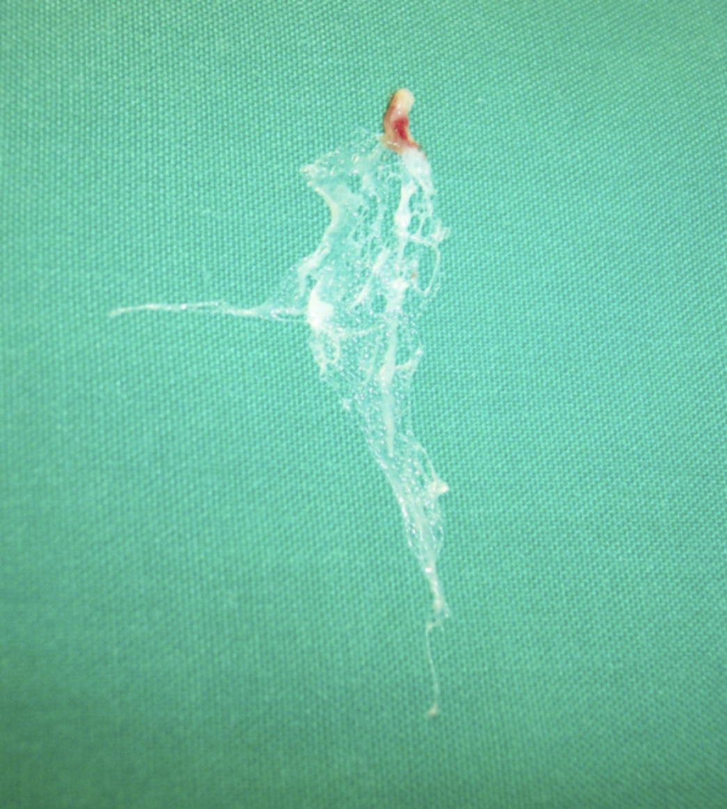 Chiari's Network and Paroxysmal Atrial Fibrillation | Revista Española ...