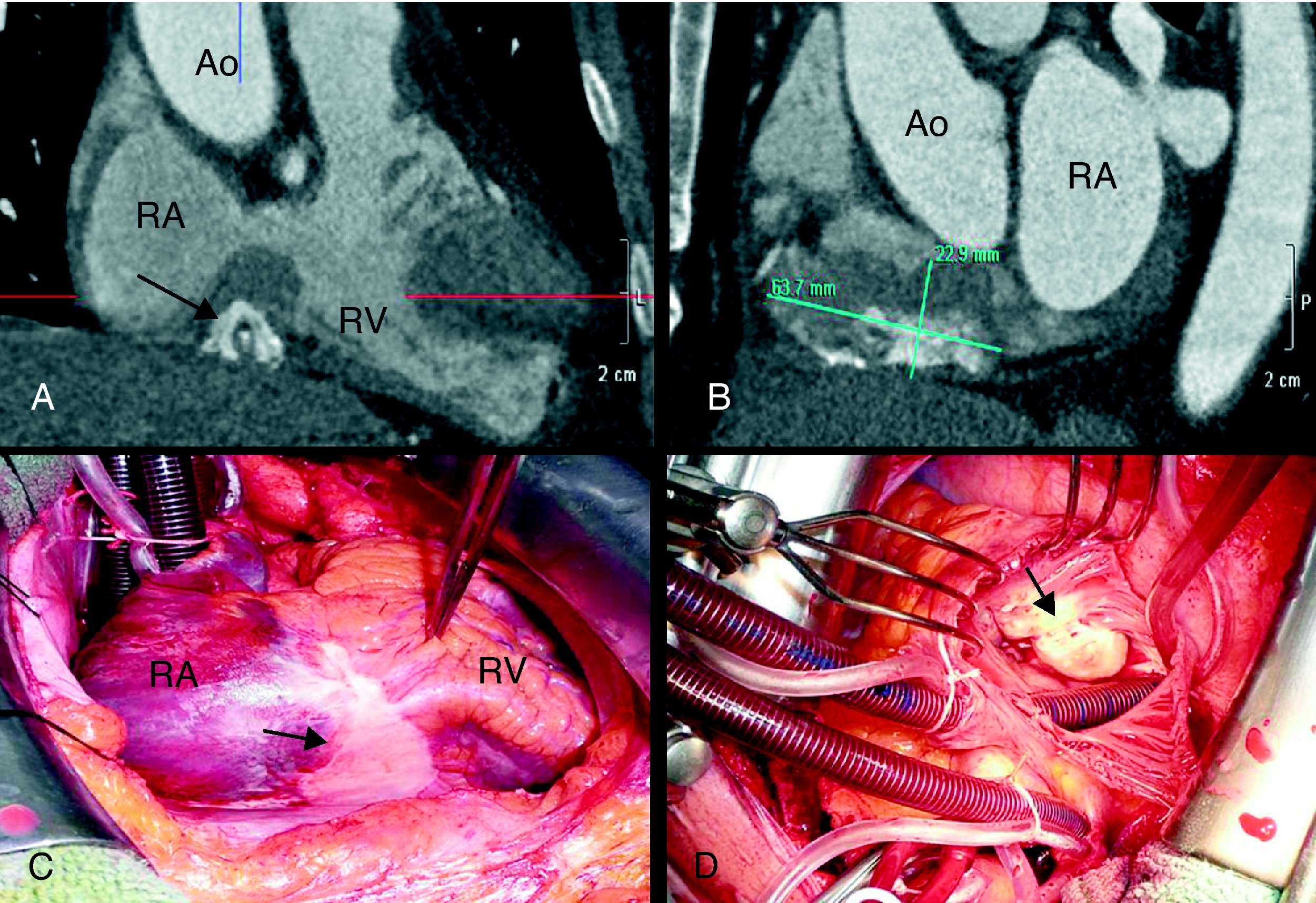 An Unusual Case of Transmural Calcifying Inflammatory Pseudotumor of ...