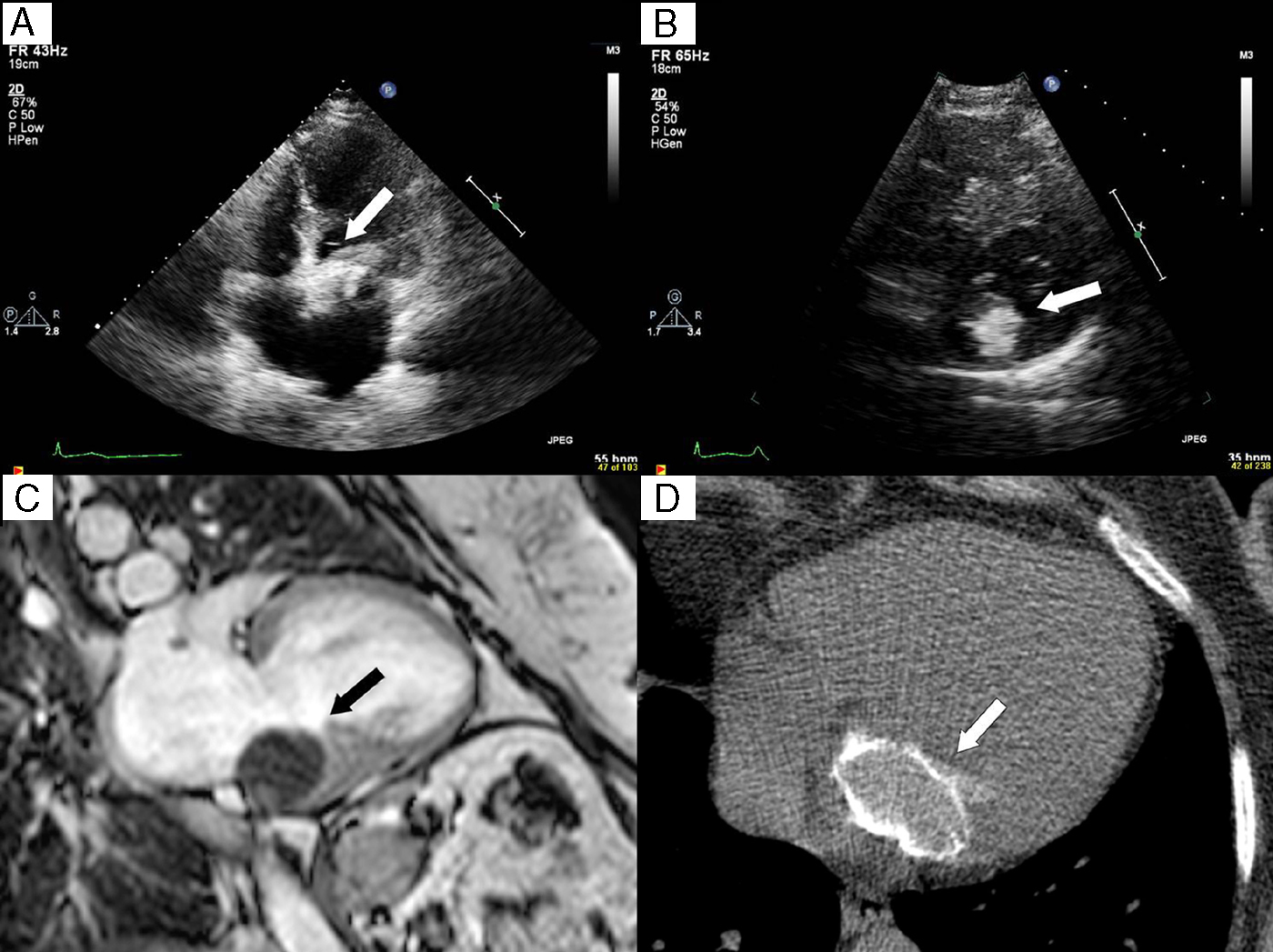 Caseous Calcification of the Mitral Annulus, a Rare Echocardiographic ...