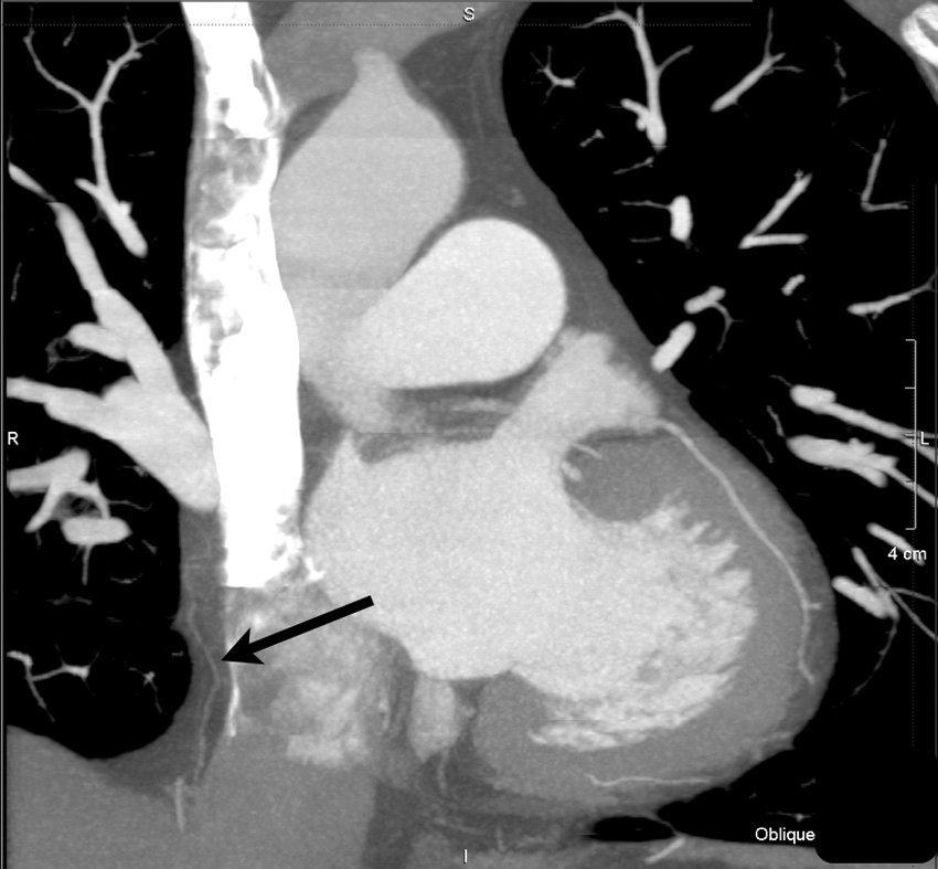Phrenic Nerve Identification With Cardiac Multidetector Computed ...