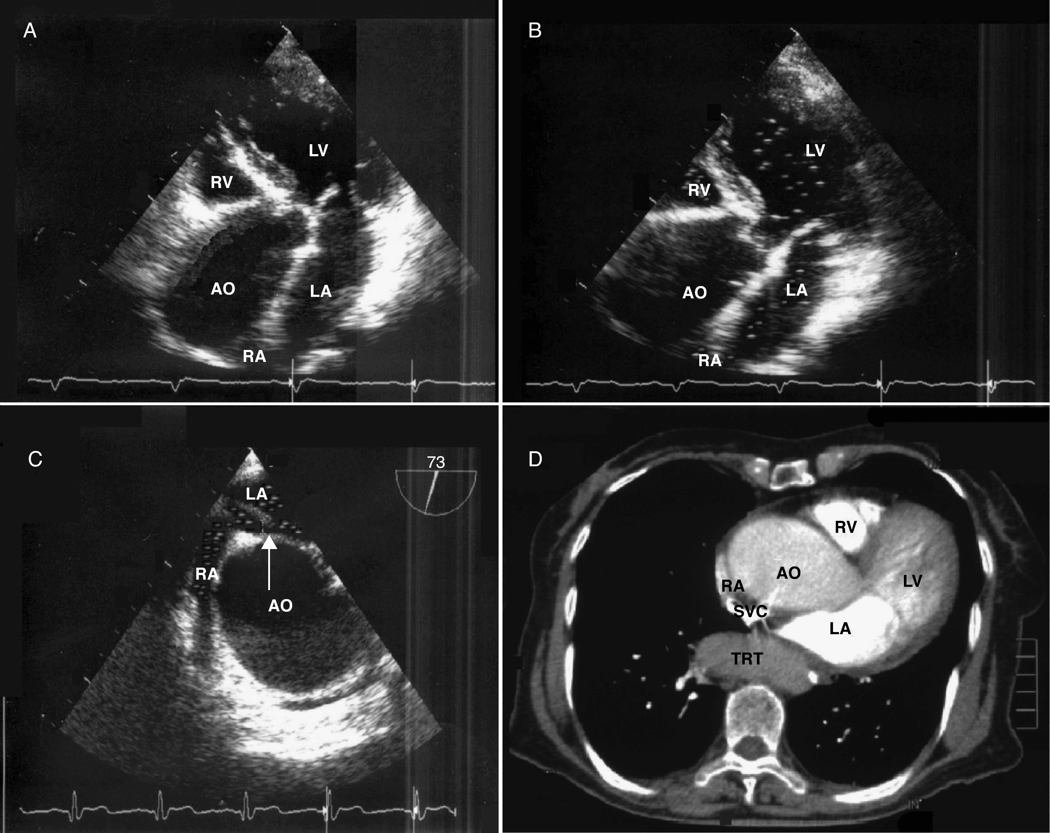 Elderly Patient With Platypnea-Orthodeoxia: Check the Ascending Aorta ...