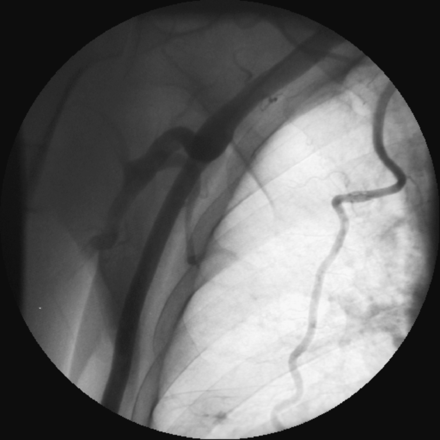 Percutaneous Coronary Intervention Through an Axillo-Bifemoral Bypass ...