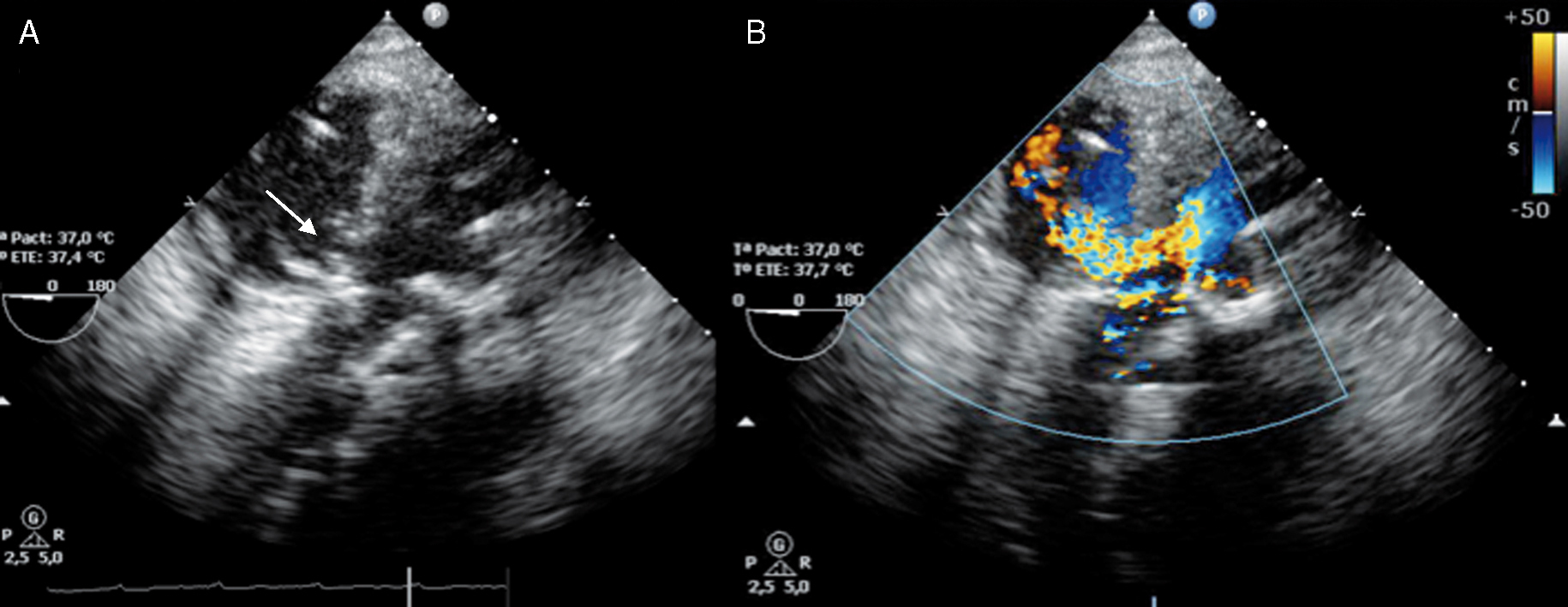 Closure of Ventricular Septal Defect After Surgical Septal Myectomy by ...