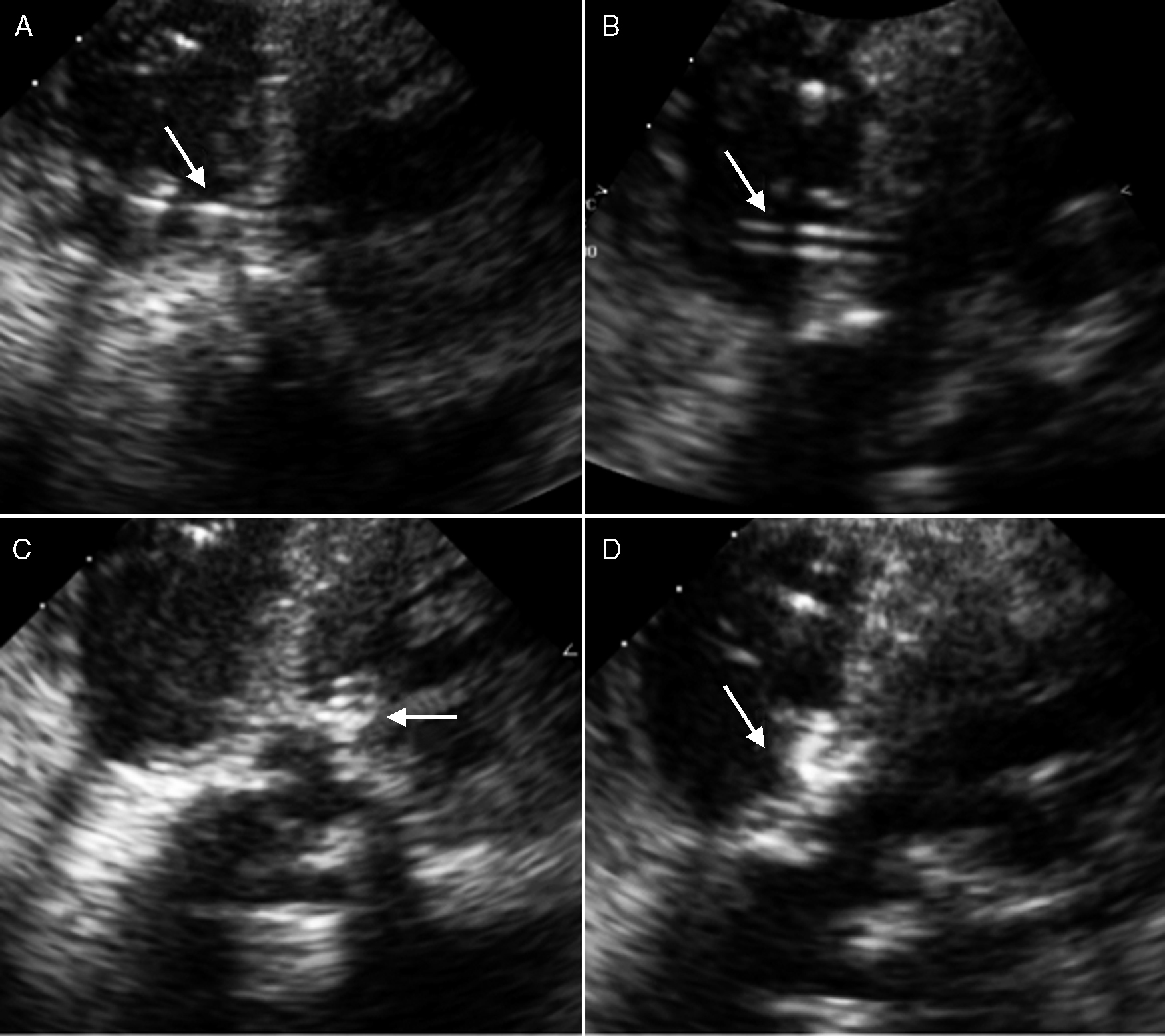 Closure of Ventricular Septal Defect After Surgical Septal Myectomy by ...