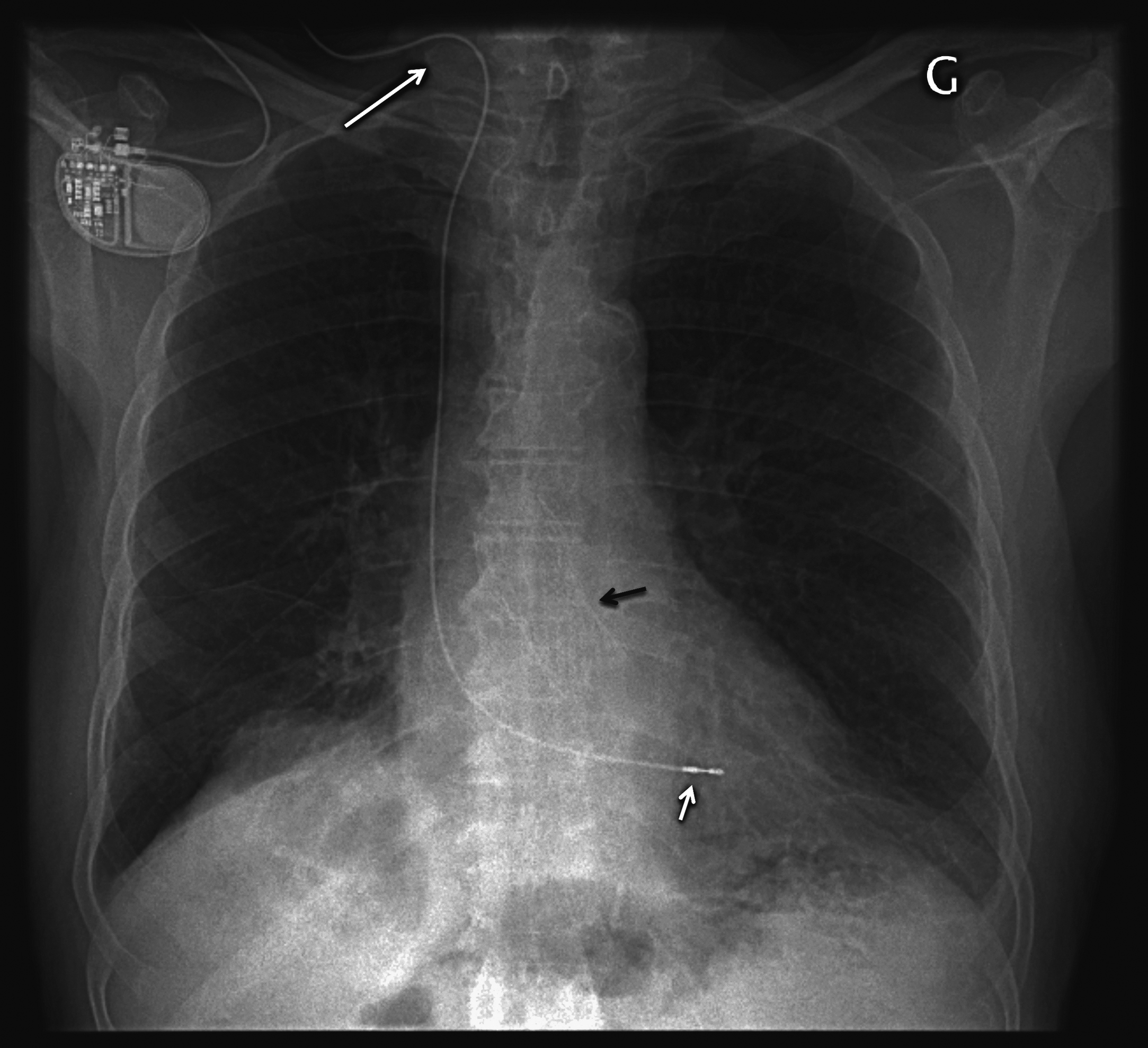Use of an Explanted Pacemaker Connected to a Regular Screw-in Lead for ...