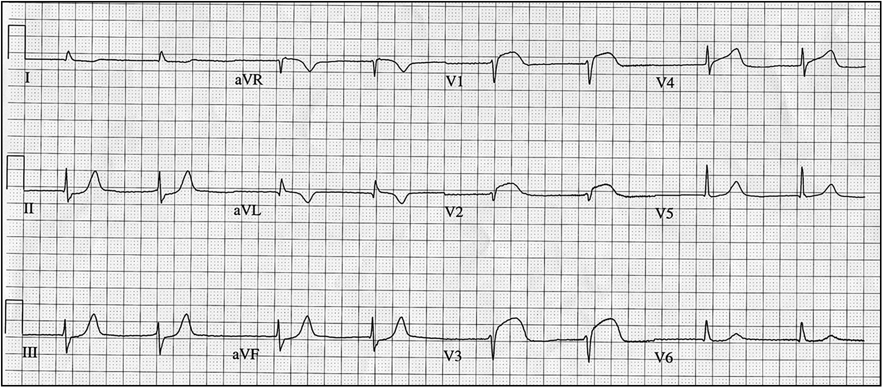 Recurrent Ventricular Fibrillation and ST Segment Elevation in the ...