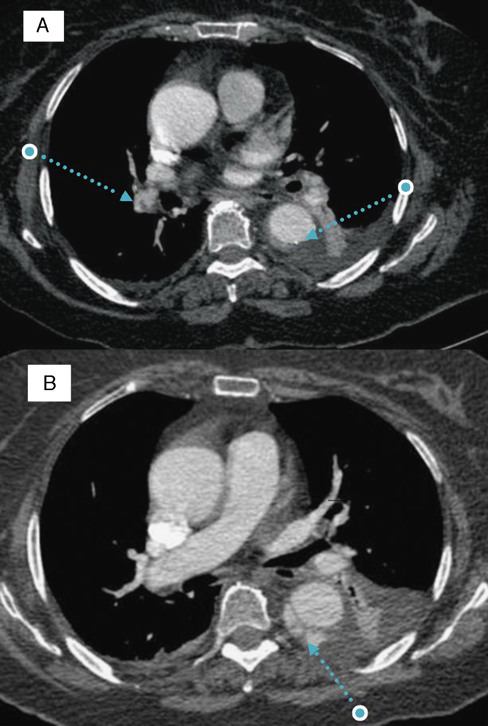 Aortic Intramural Hematoma and Pulmonary Embolism. Diagnostic Challenge ...
