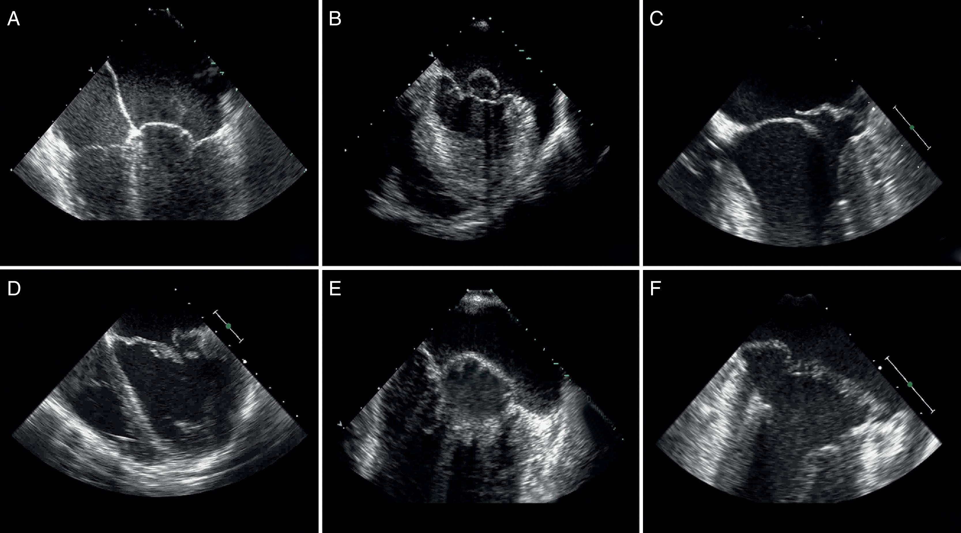 Surgical Echocardiography of the Mitral Valve | Revista Española de ...