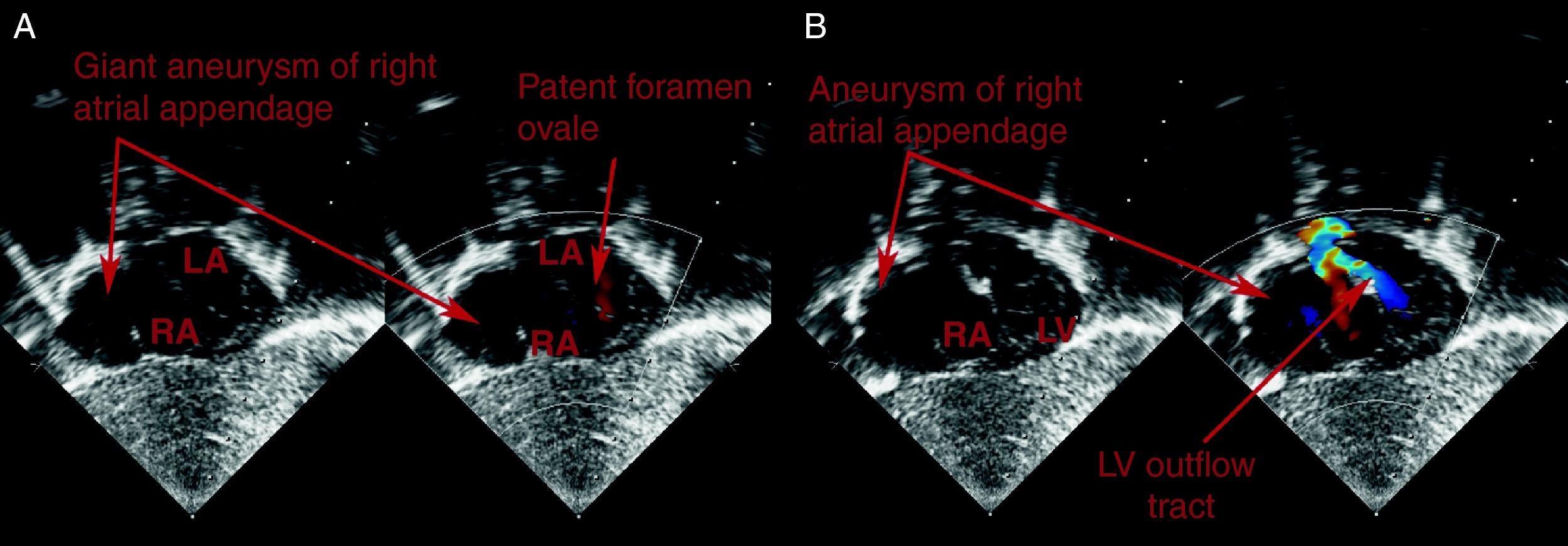 Congenital Aneurysm of the Right Atrial Appendage in a Newborn: a Rare ...
