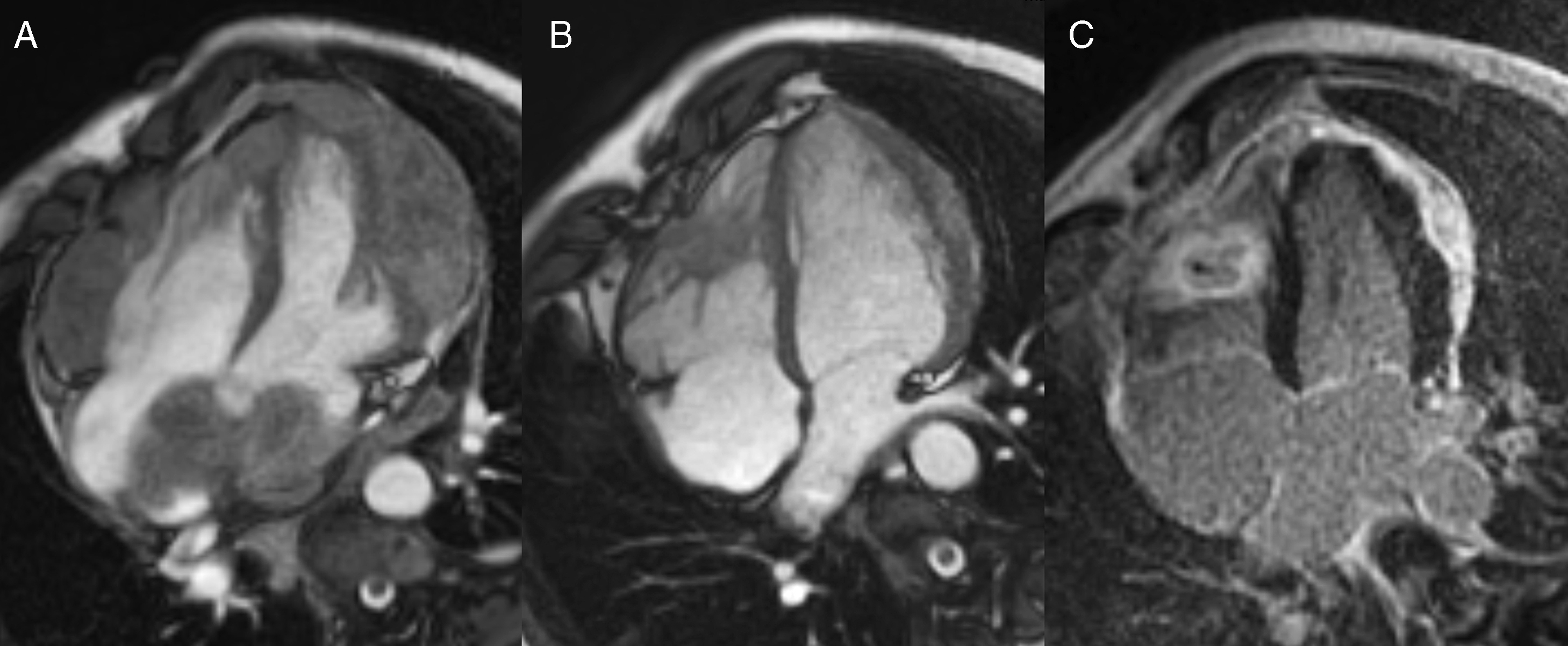 Myocardial Tuberculosis | Revista Española de Cardiología