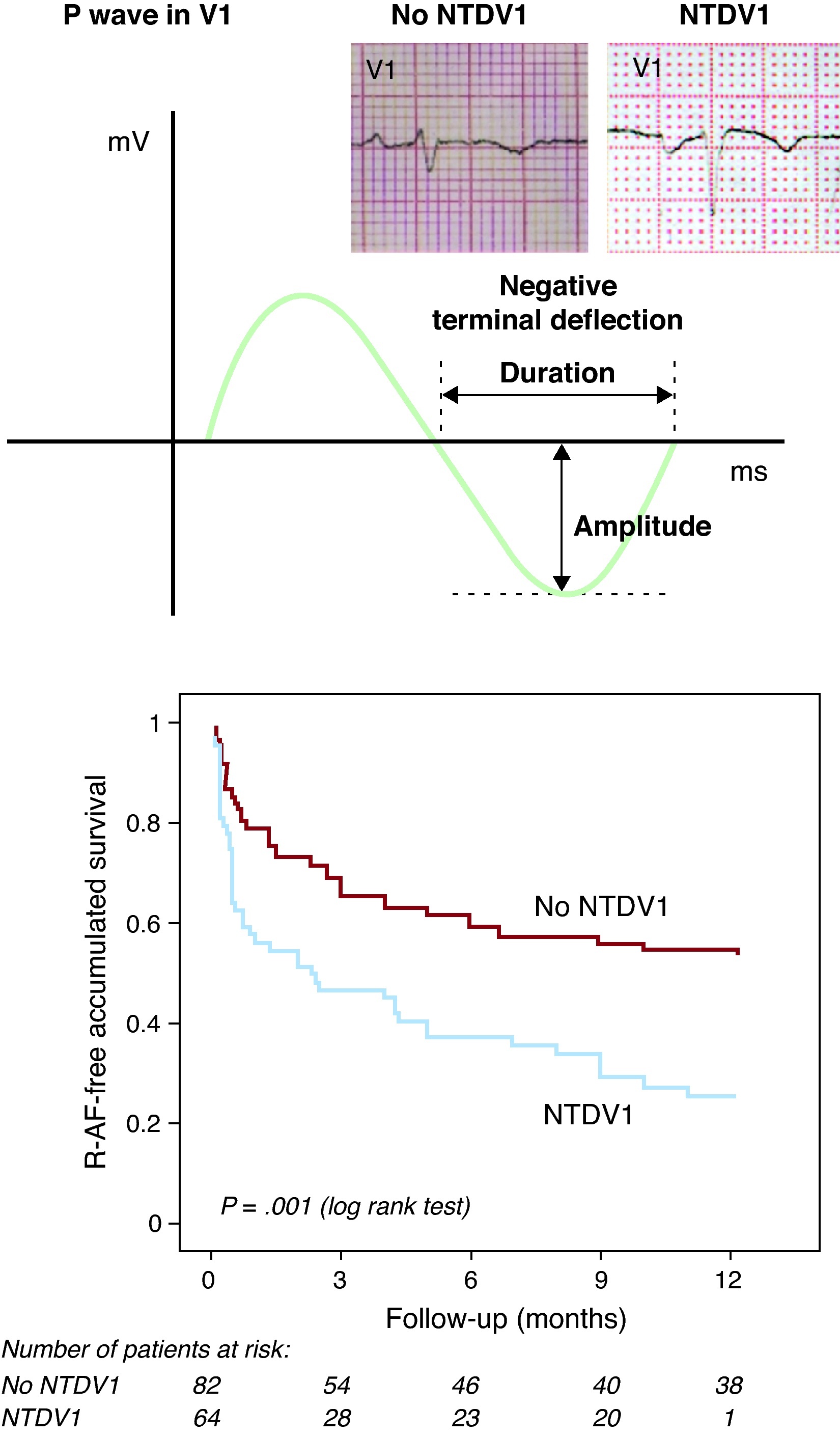 P Wave Morphology and Recurrence After Cardioversion of Lone Atrial ...