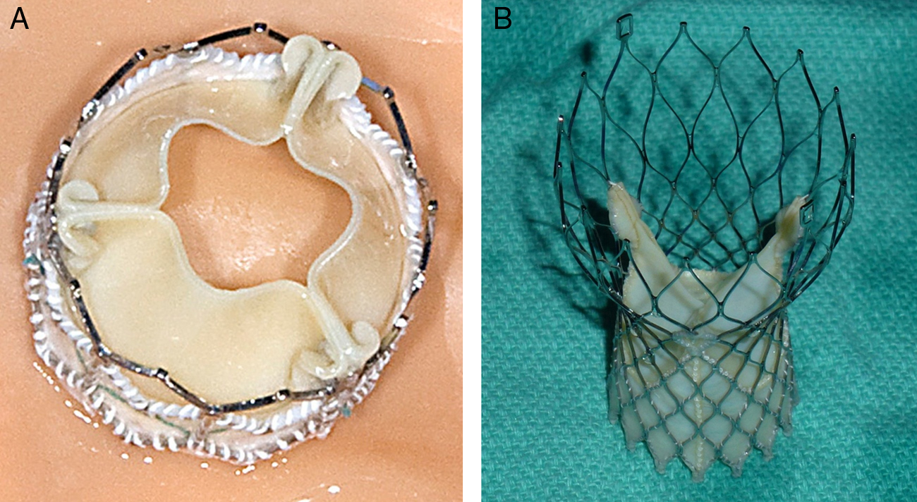 Indications for Transcatheter Aortic Valve Replacement Based on the ...