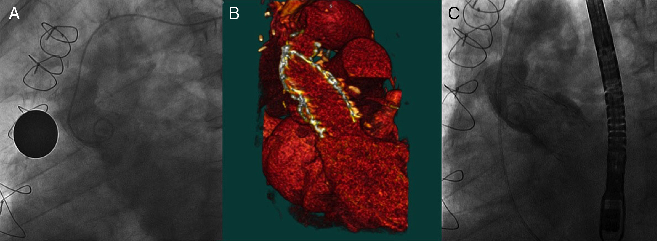 Transcatheter Aortic Valve Implantation, Safety and Effectiveness of ...
