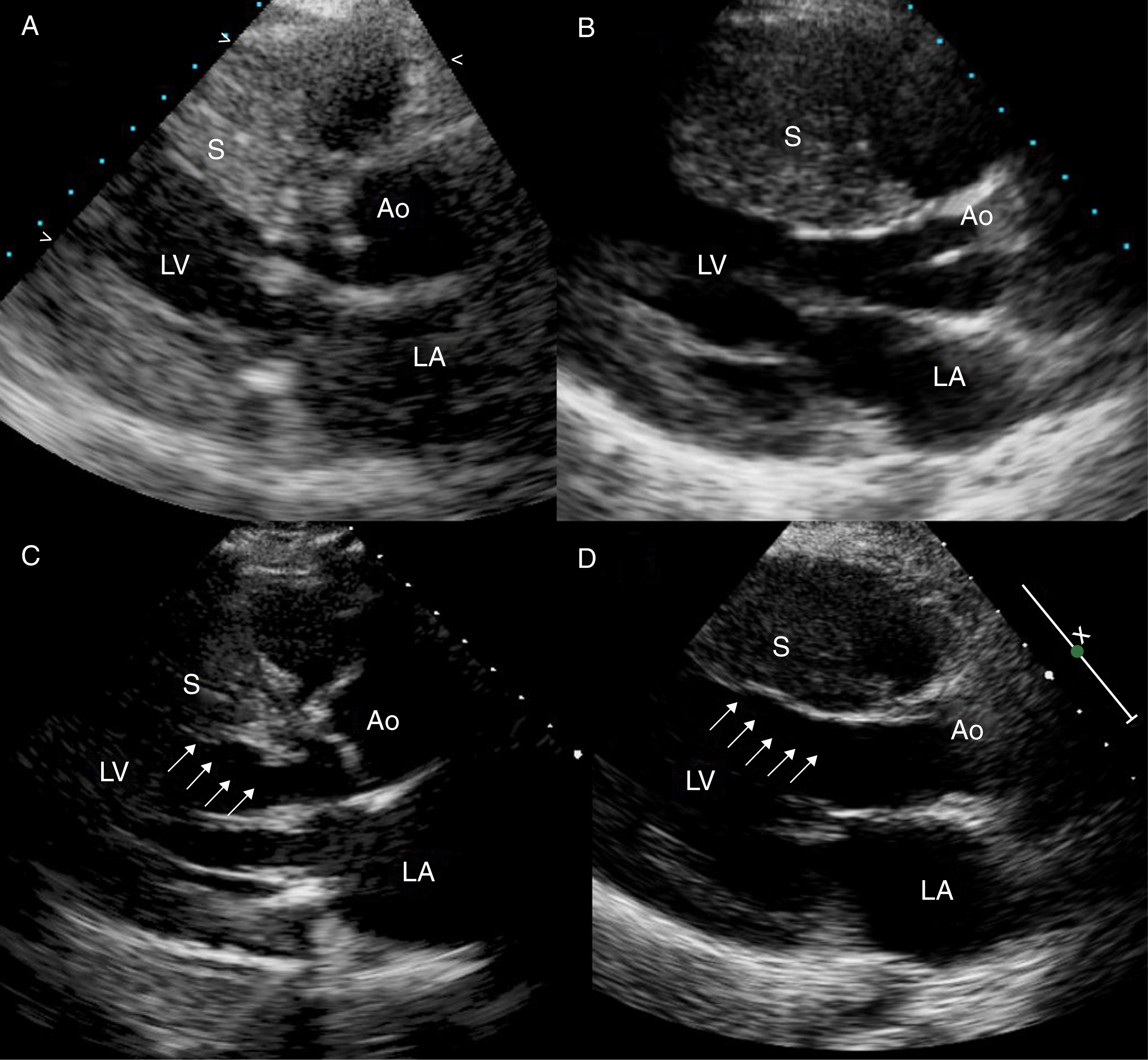 Alcohol Septal Ablation in Hypertrophic Cardiomyopathy, An Opportunity ...