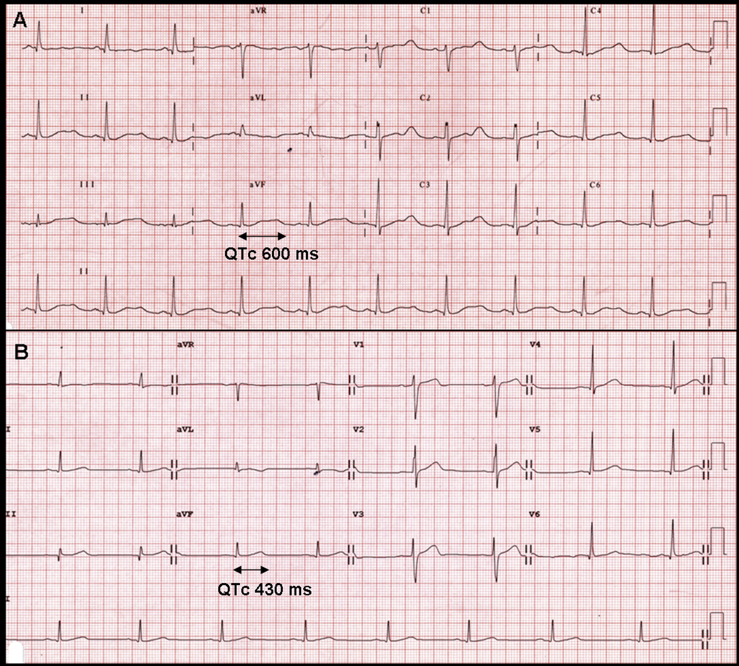 An Unusual Etiology for Long QT | Revista Española de Cardiología
