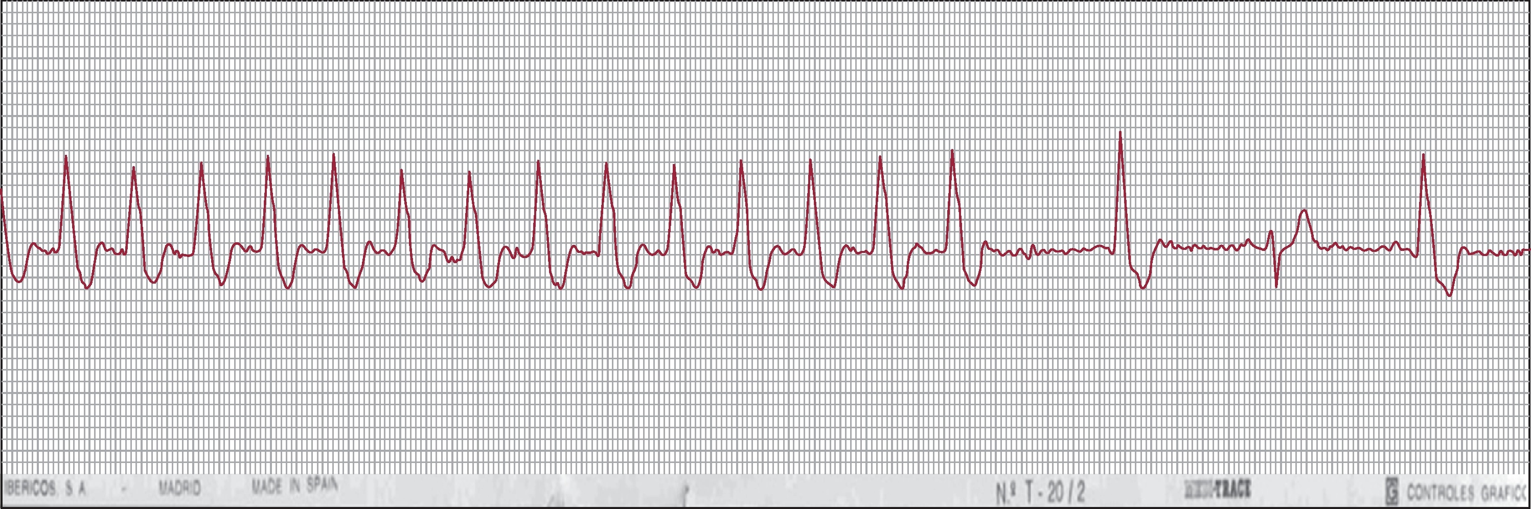 Paroxysmal Supraventricular Tachycardias and Preexcitation Syndromes ...