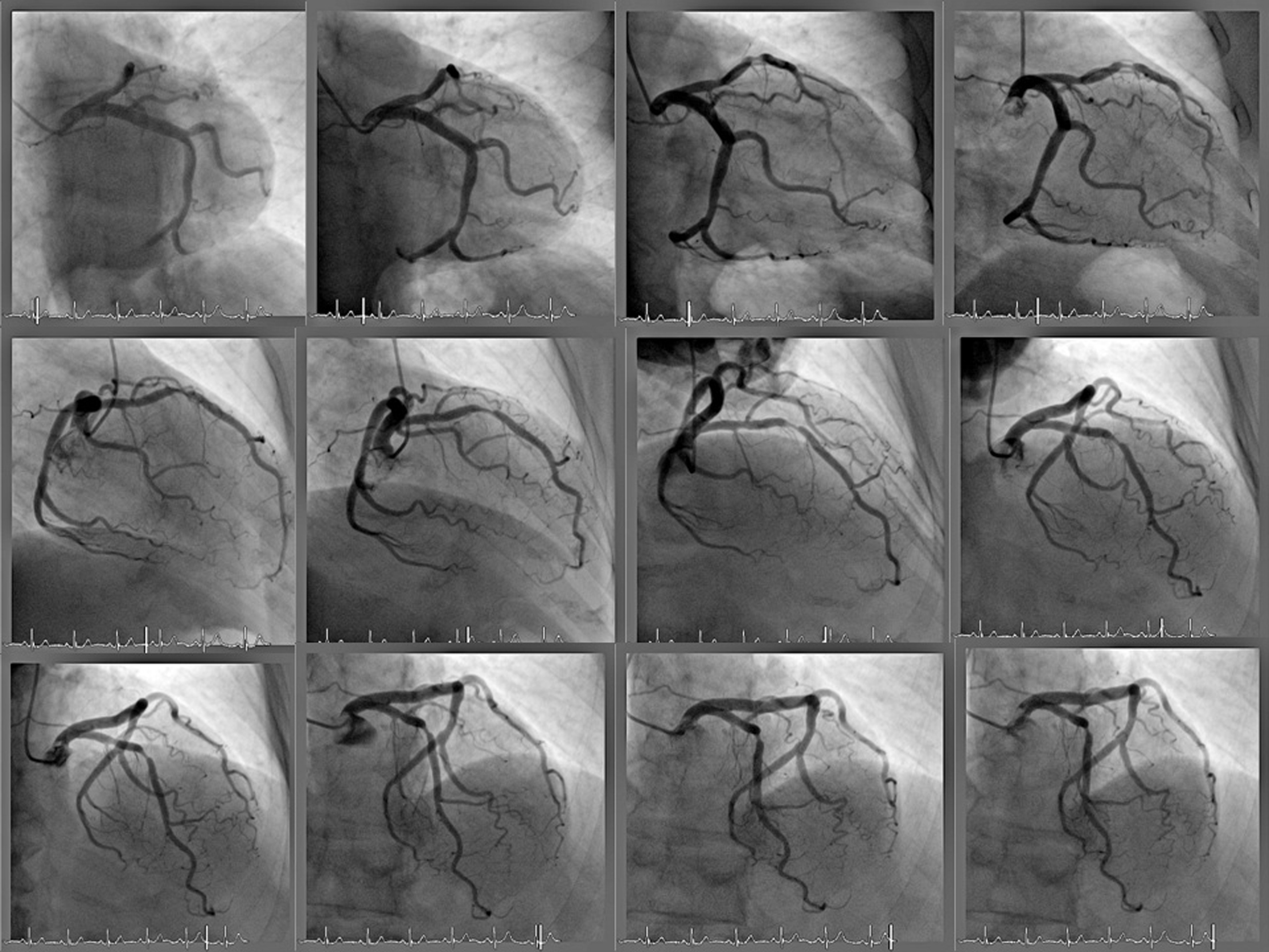 Comparison of Dual-Axis Rotational Coronary Angiography (XPERSWING ...