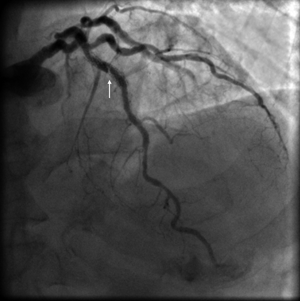 Intrastent Coronary Dissection Assessed With Optical Coherence Tomography