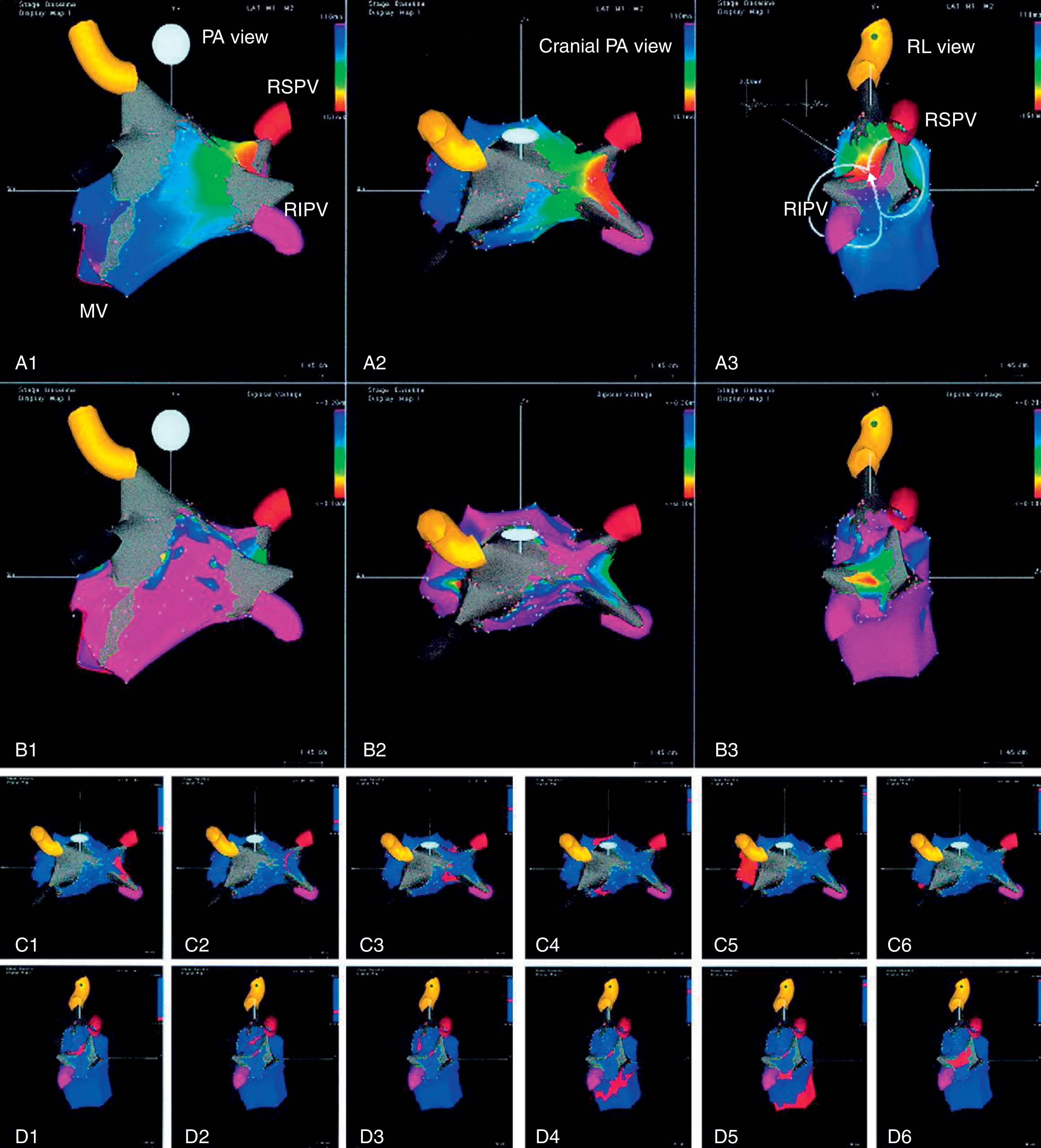 Atrial Fibrillation Ablation | Revista Española de Cardiología