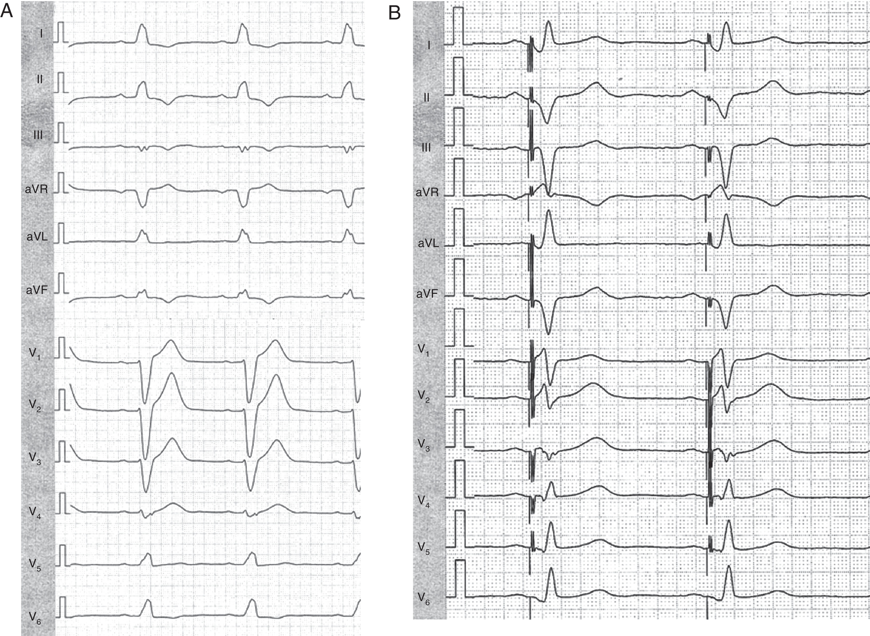 How to Assess the Nonresponder to Cardiac Resynchronization Therapy–A ...