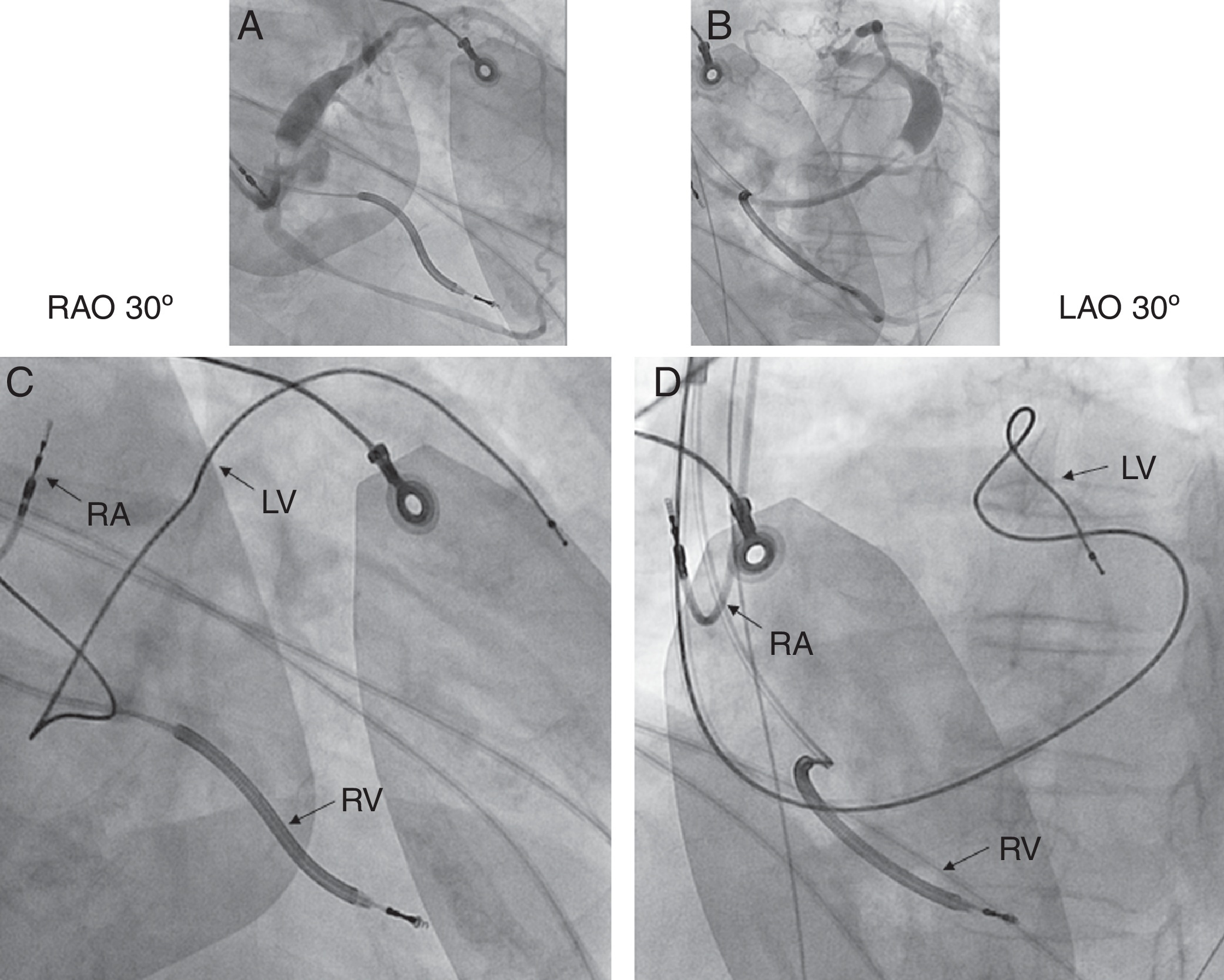 How to Assess the Nonresponder to Cardiac Resynchronization Therapy–A ...