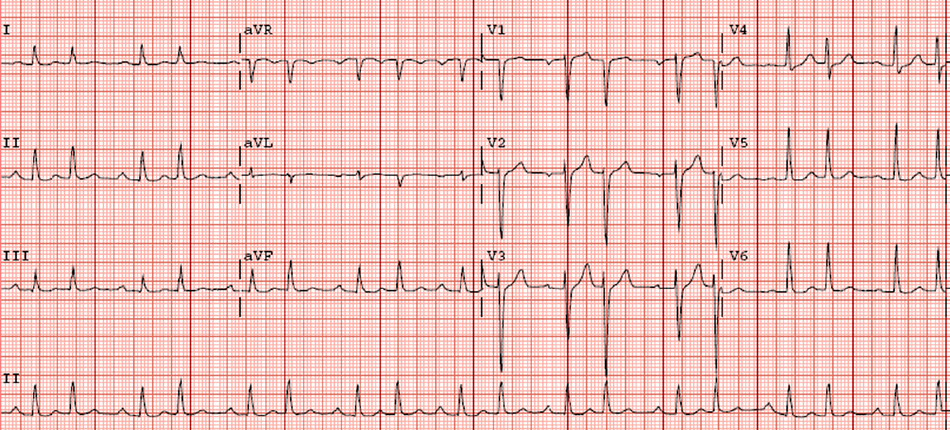 Incessant Double Ventricular Response and Paroxysmal Atrial ...