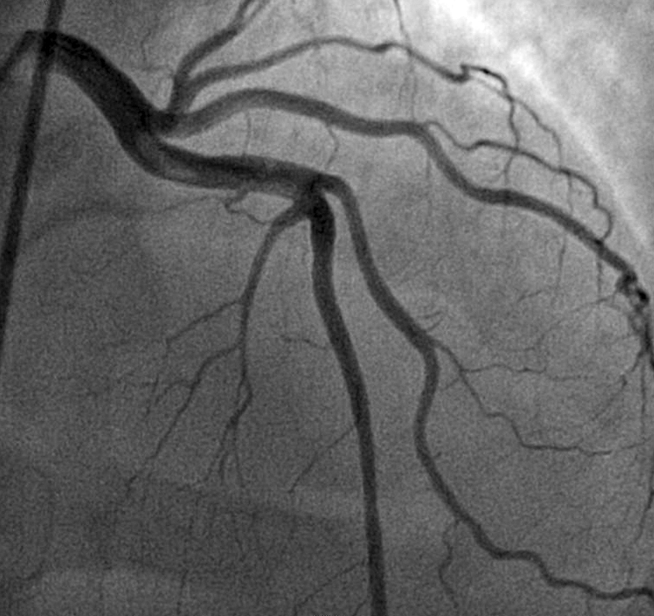 Acute Myocardial Infarction for Thrombotic Occlusion in Patient With ...