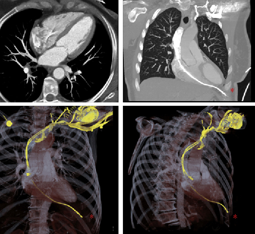 Ventricular Perforation and Active Fixation Leads, New Entity ...