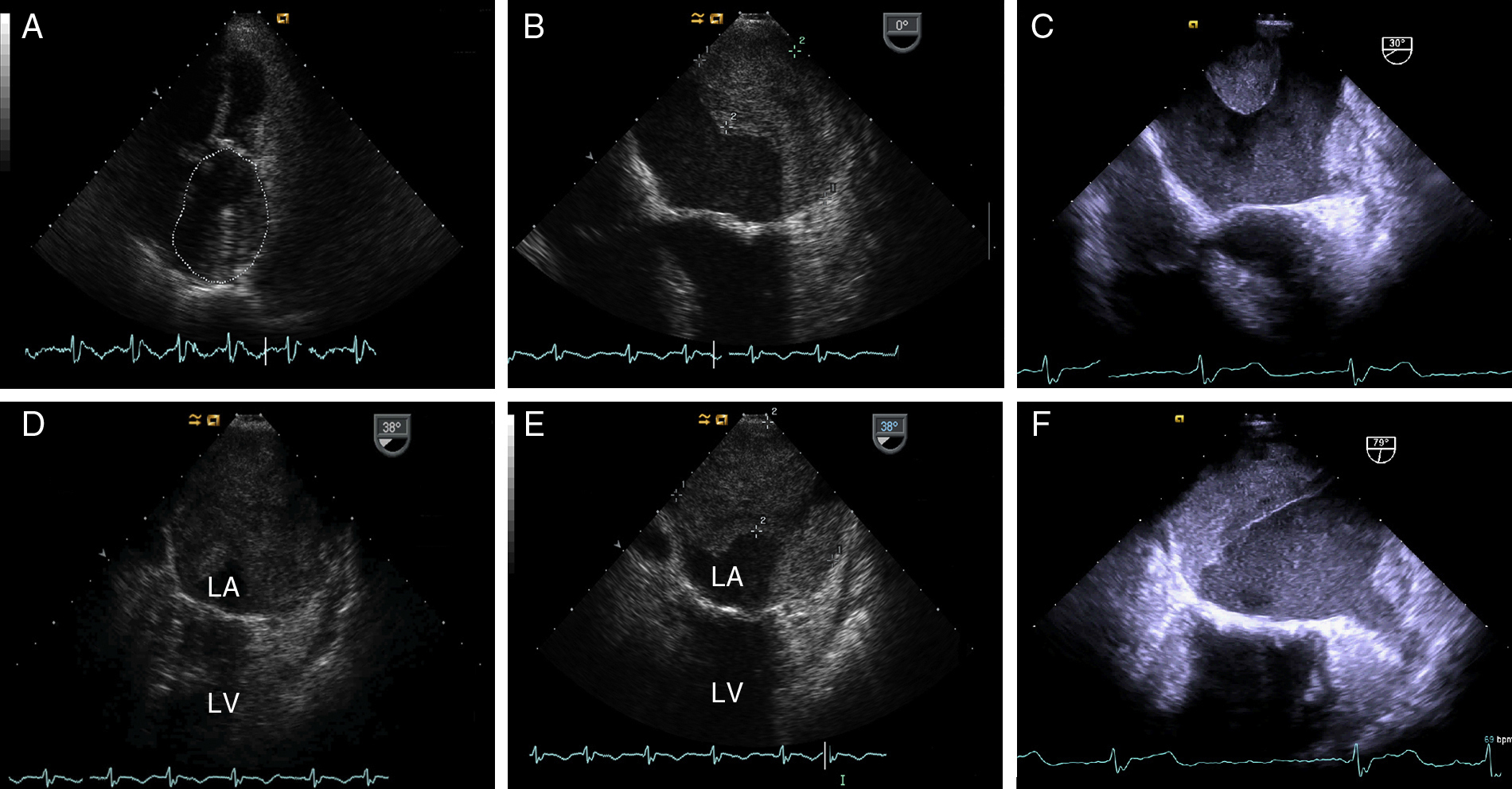 Phantom Pneumonia | Revista Española de Cardiología