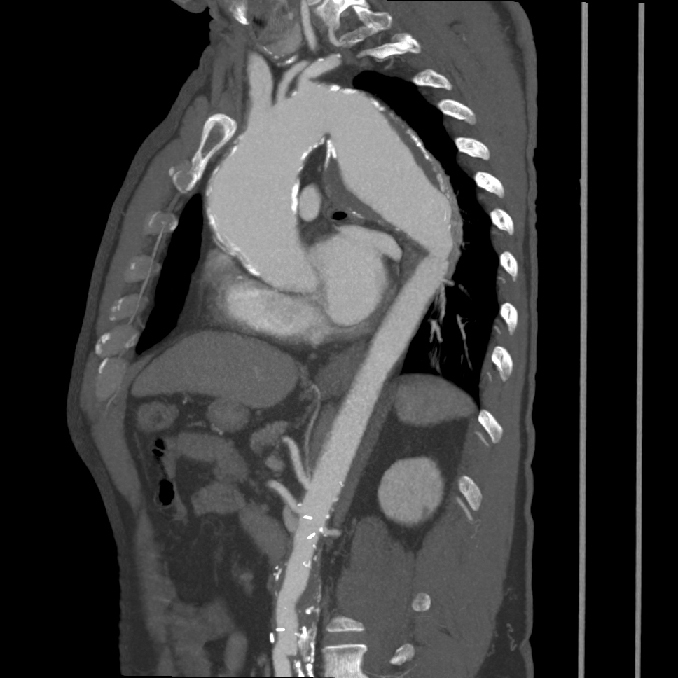 Simultaneous Replacement of Complete Thoracic Aorta