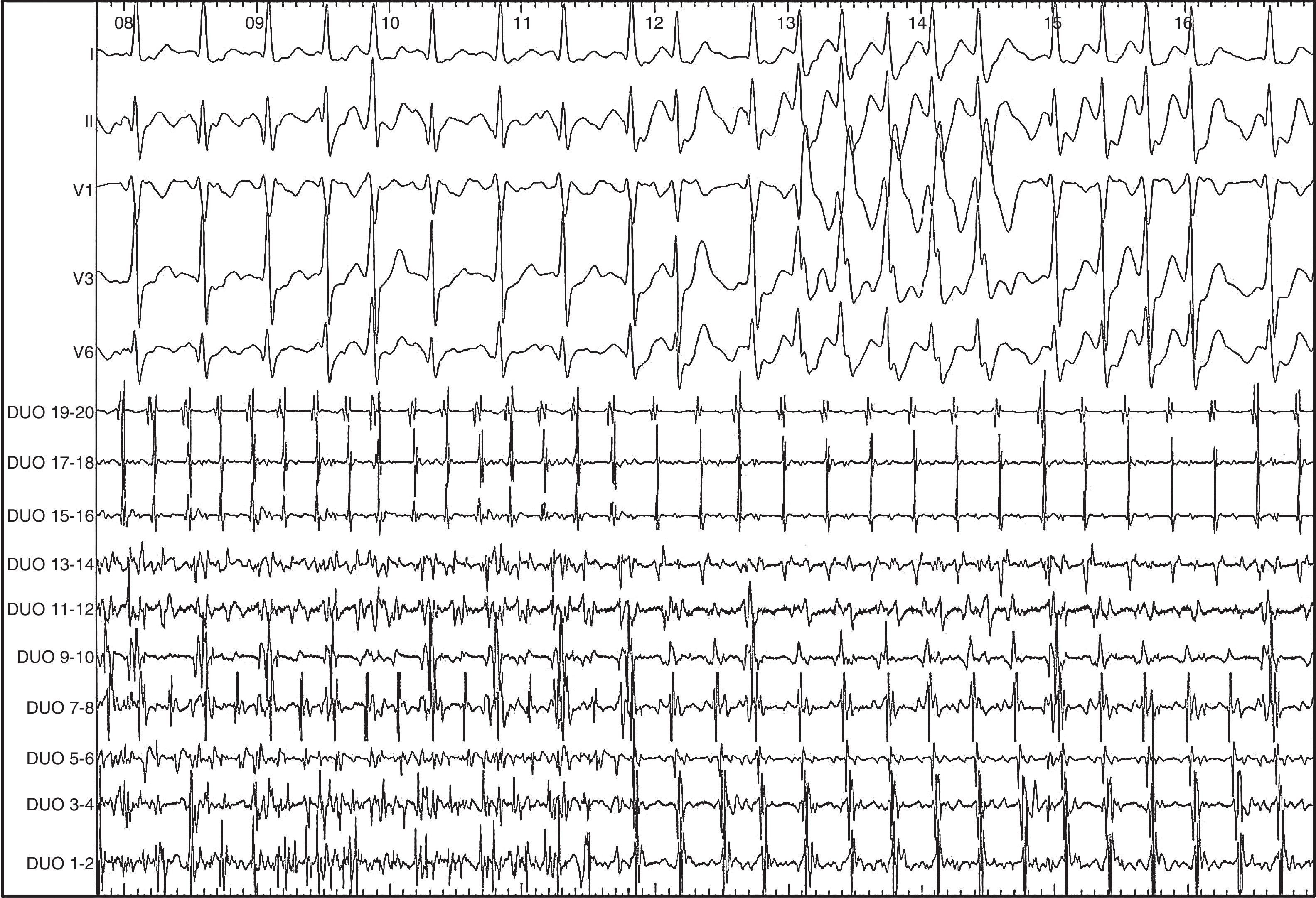 1:1 Atrial Flutter After Vernakalant Administration for Atrial ...