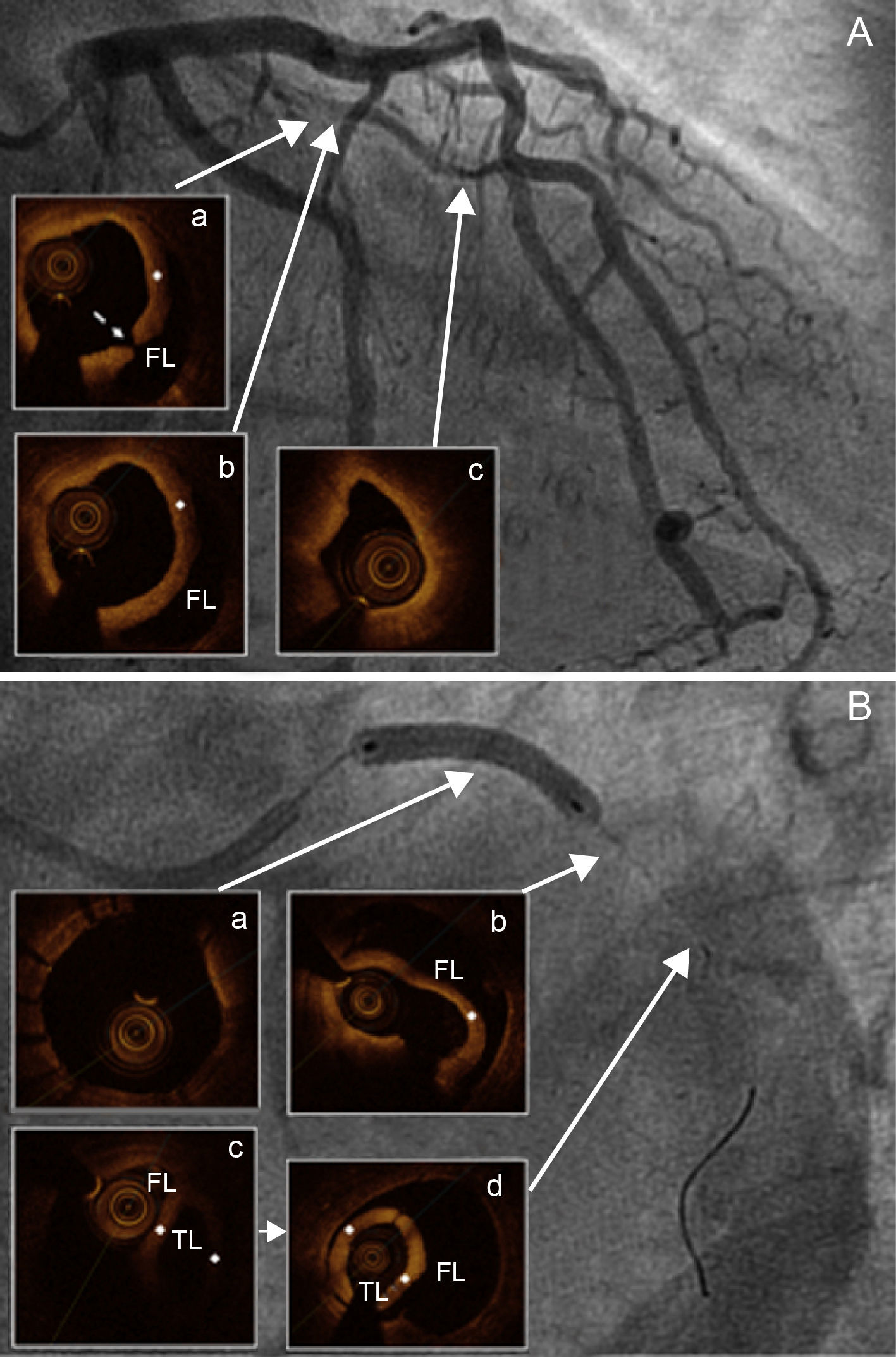 Optical Coherence Tomography in Spontaneous Coronary Dissection and in ...